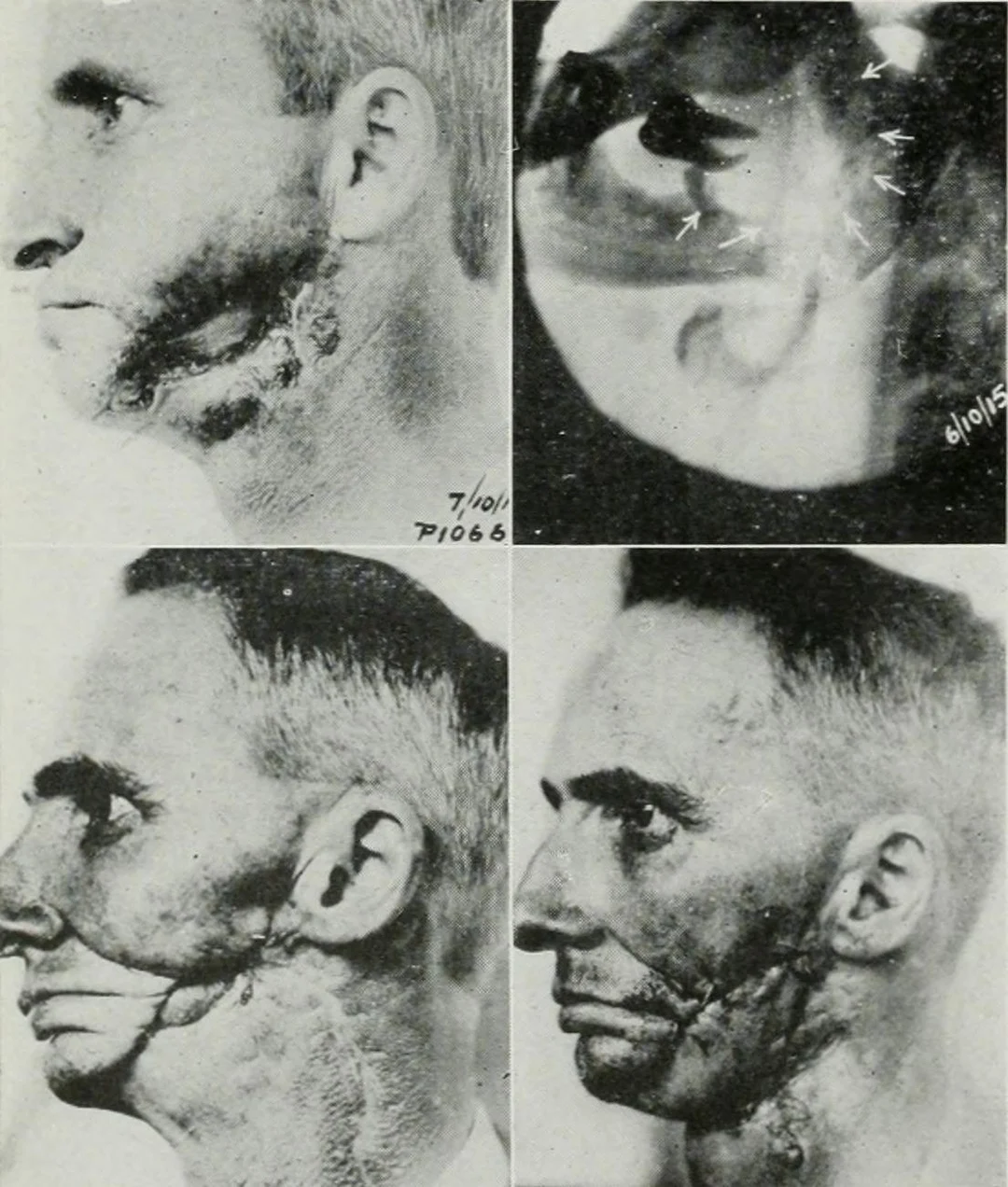 Radium jaw | Scrolller