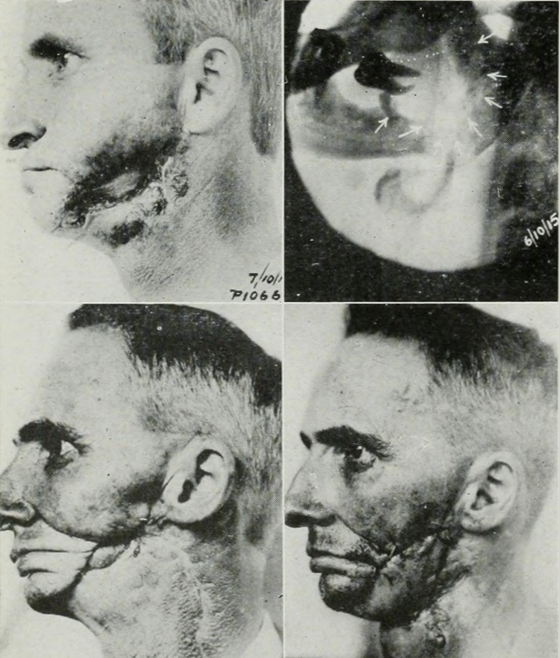 Radium jaw | Scrolller