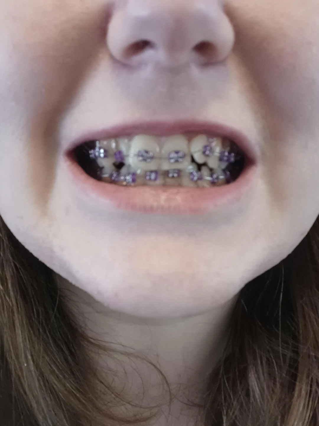 Braces day 1! | Scrolller