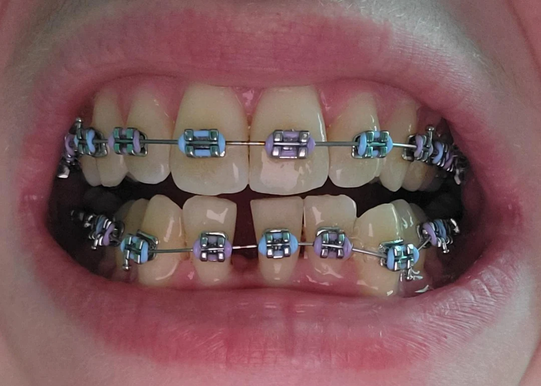 First adjustment appointment which means new colors! | Scrolller