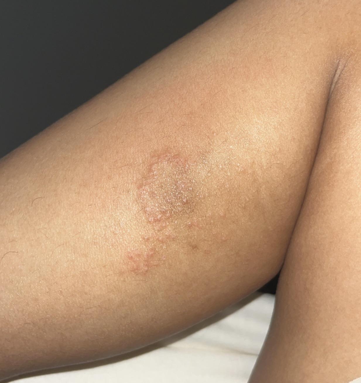 Skin Infection? | Scrolller