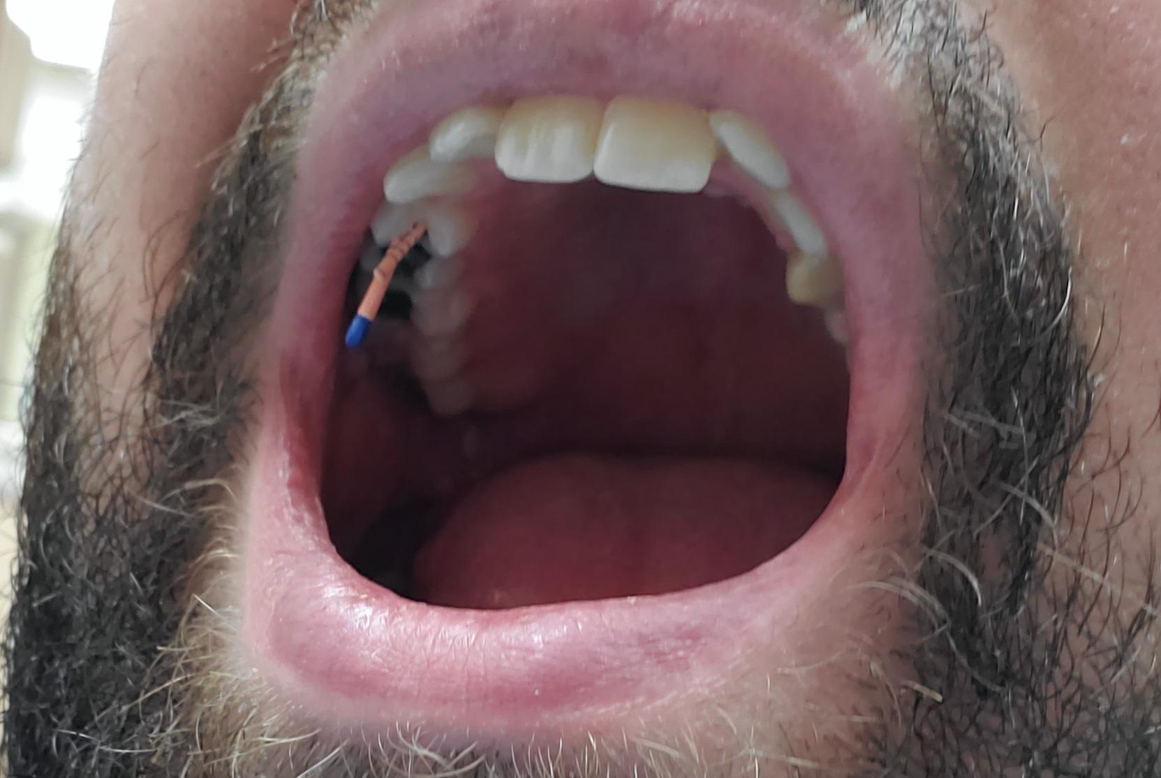 What is this thing the dentist stuck in my tooth during a root canal? | Scrolller