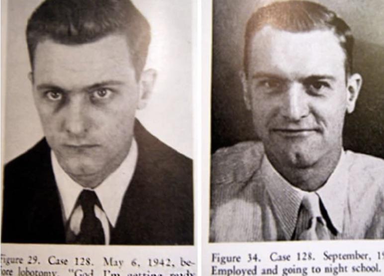 Picture of a man with Schizophrenia before and after his Lobotomy | Scrolller