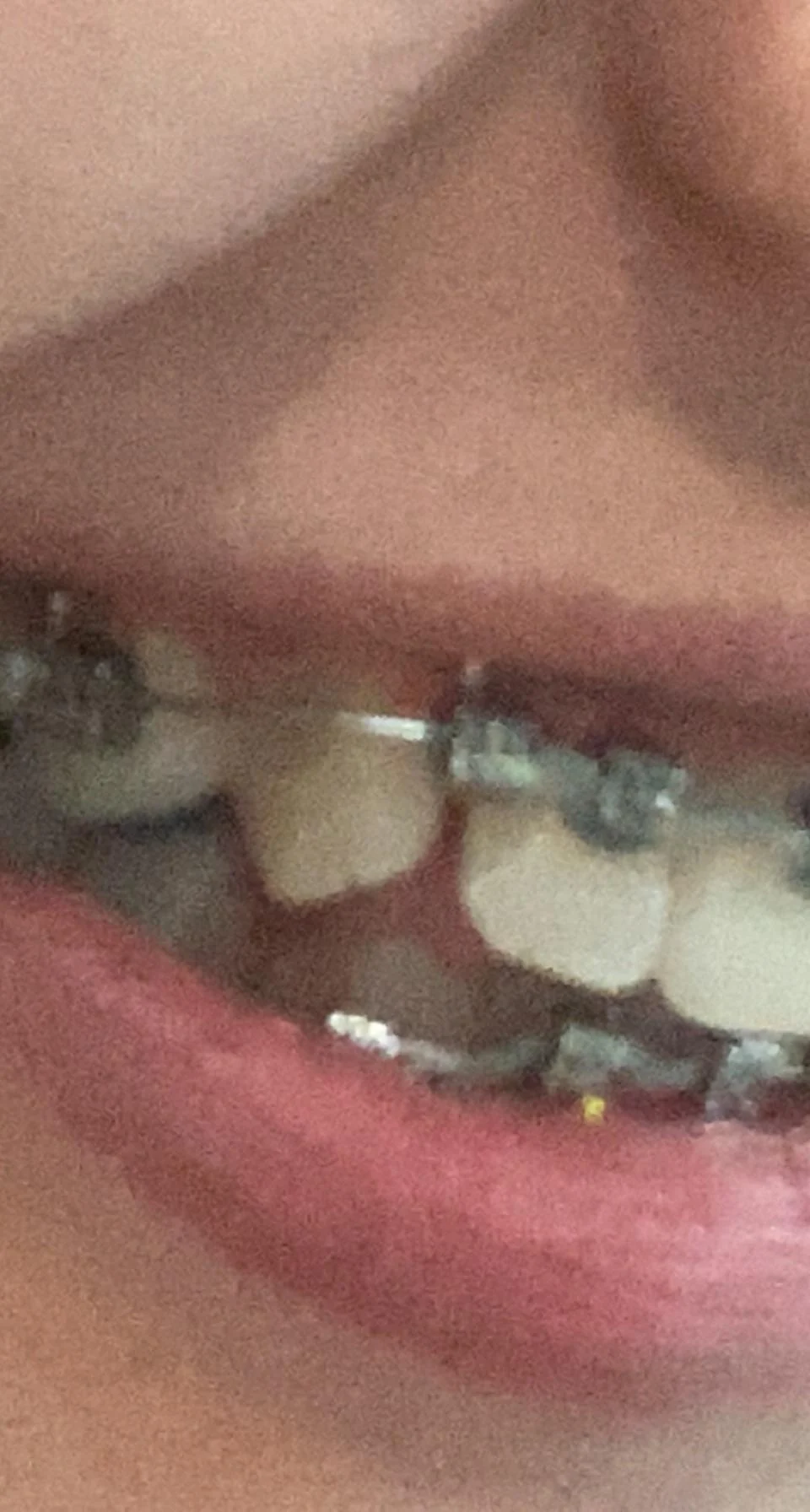 Is it weird that the bracket isn’t on my tooth? | Scrolller
