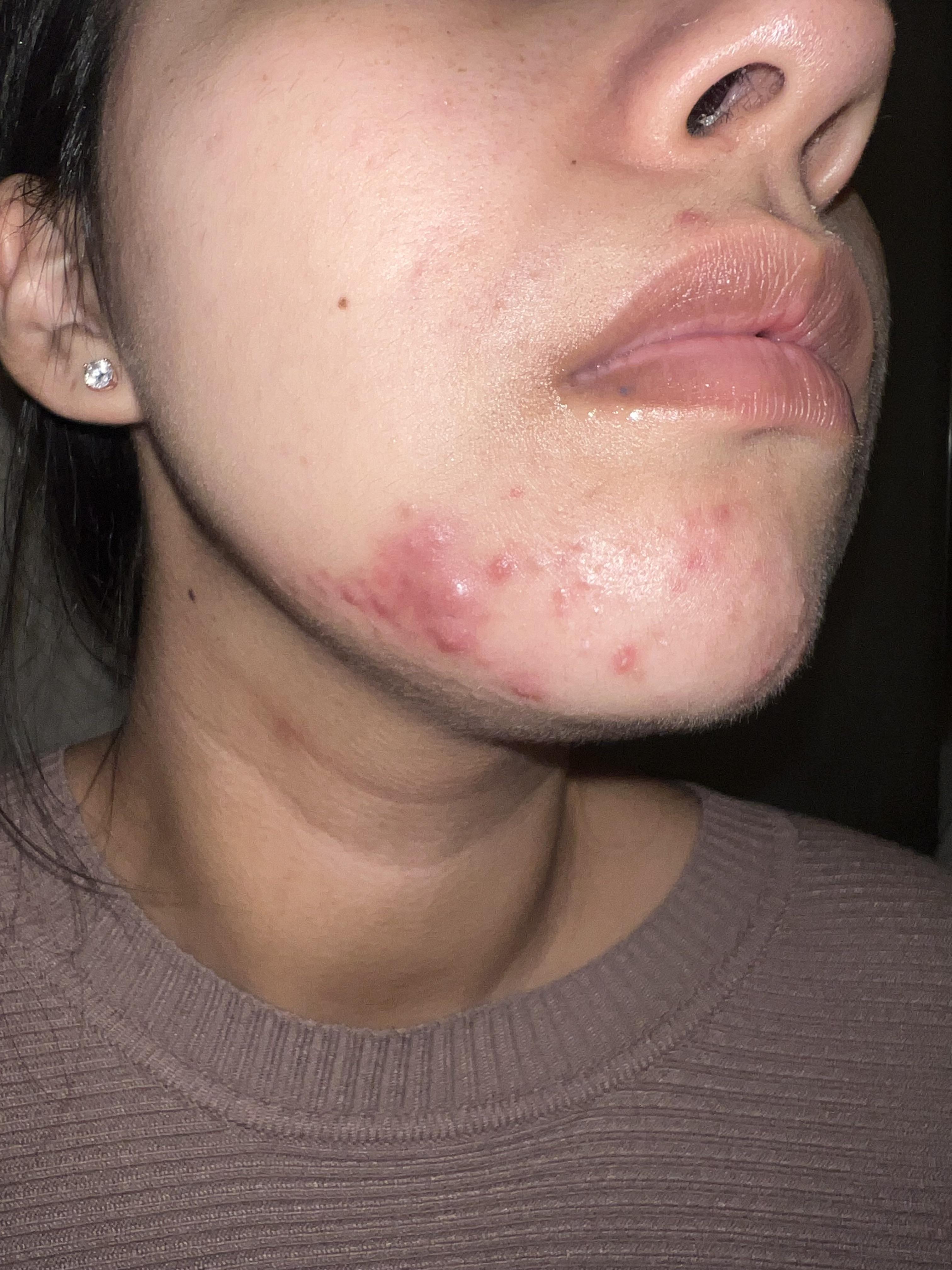 Discover more like Acne: Help I’m embarrassed to be seen like this and Related Content | Scrolller