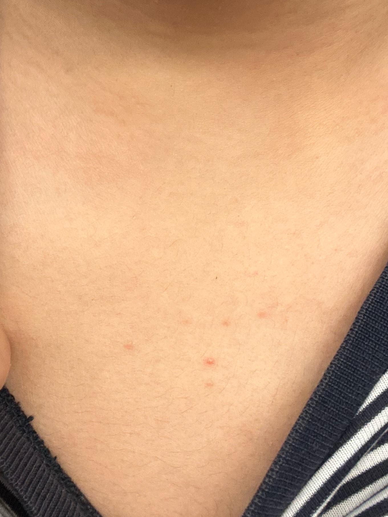 Weird bumps on chest - appeared after I started sleeping naked | Scrolller