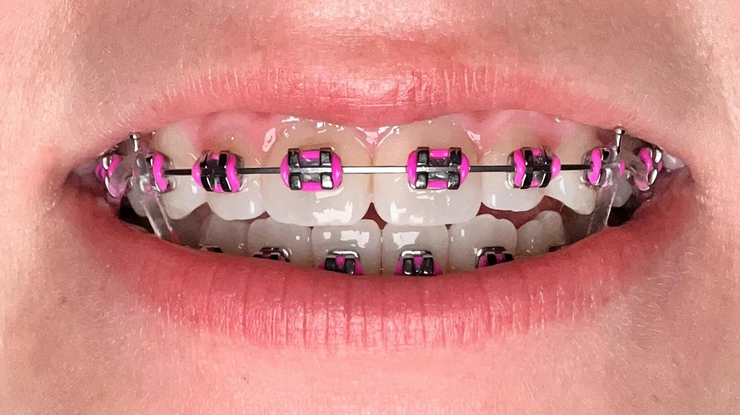 My braces | Scrolller