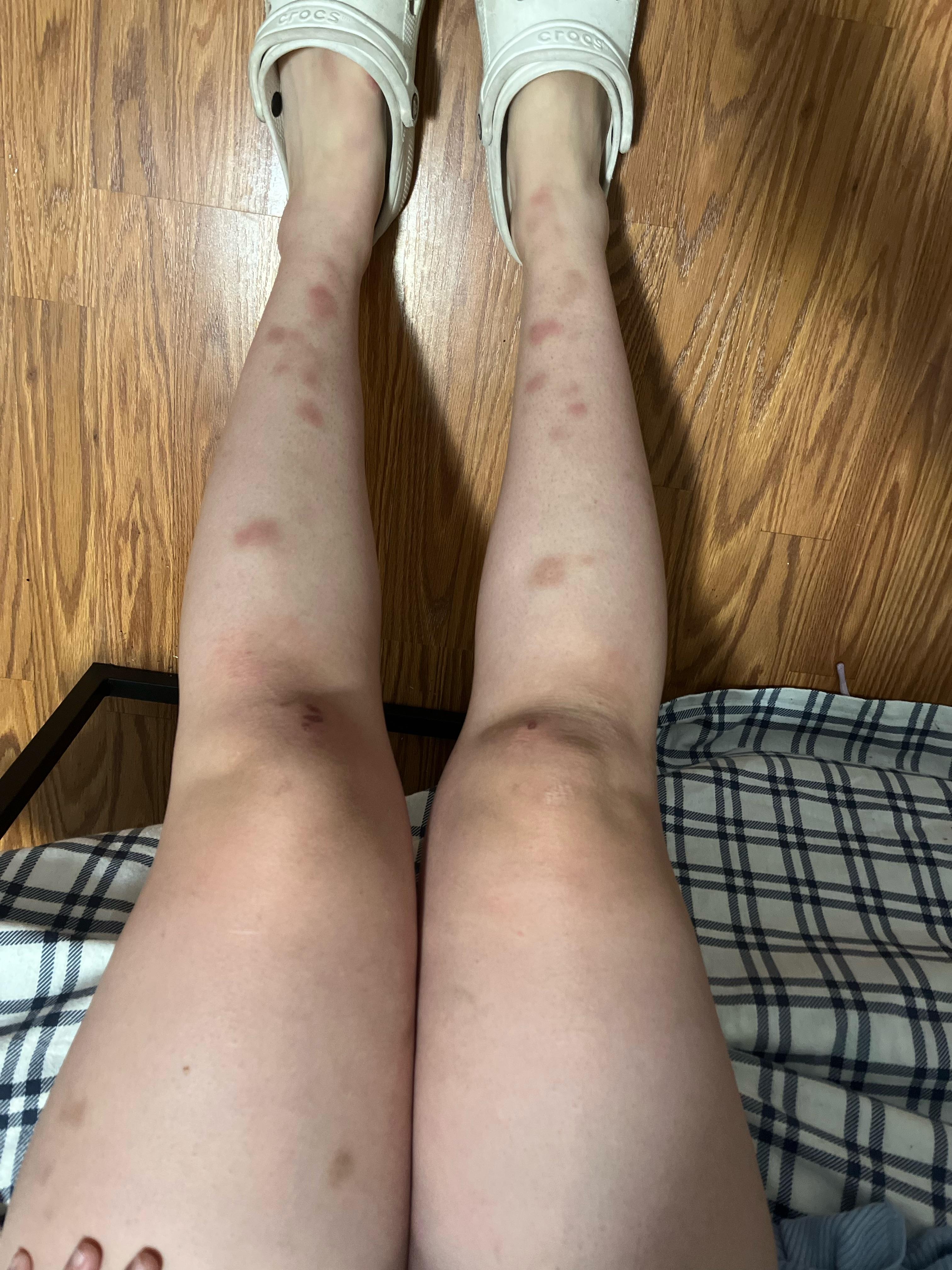 Help with bruises | Scrolller