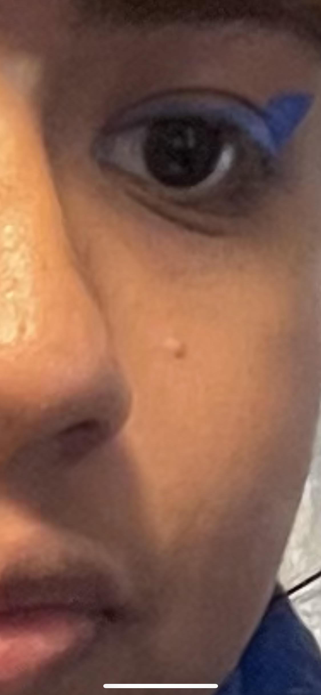 What is Is this ?? zit or a pimple? | Scrolller