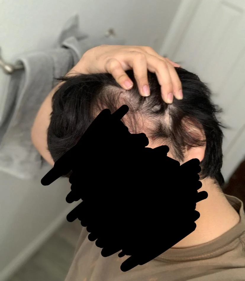 Hair loss | Scrolller