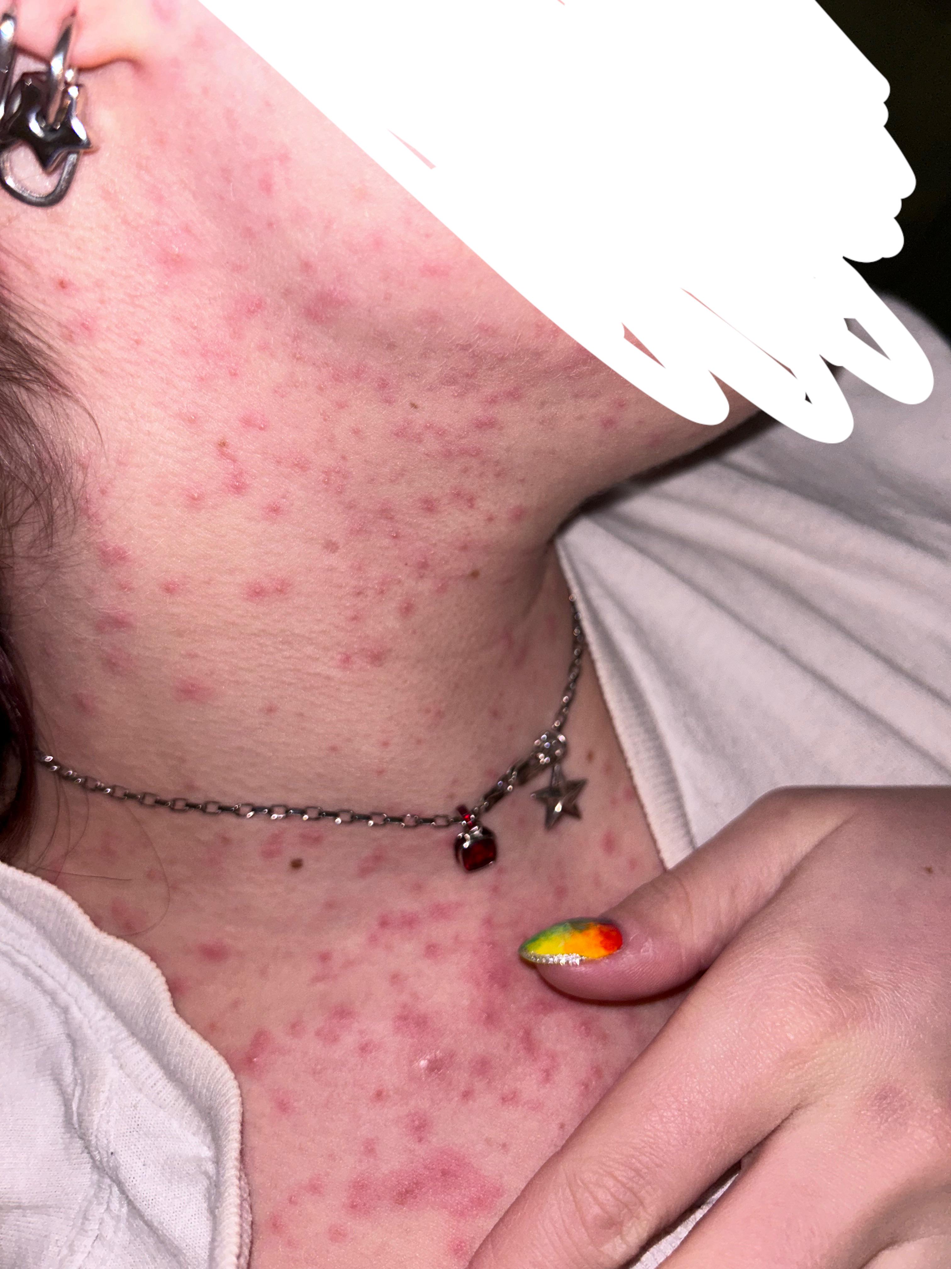 Folliculitis Nightmare!!!!! | Scrolller