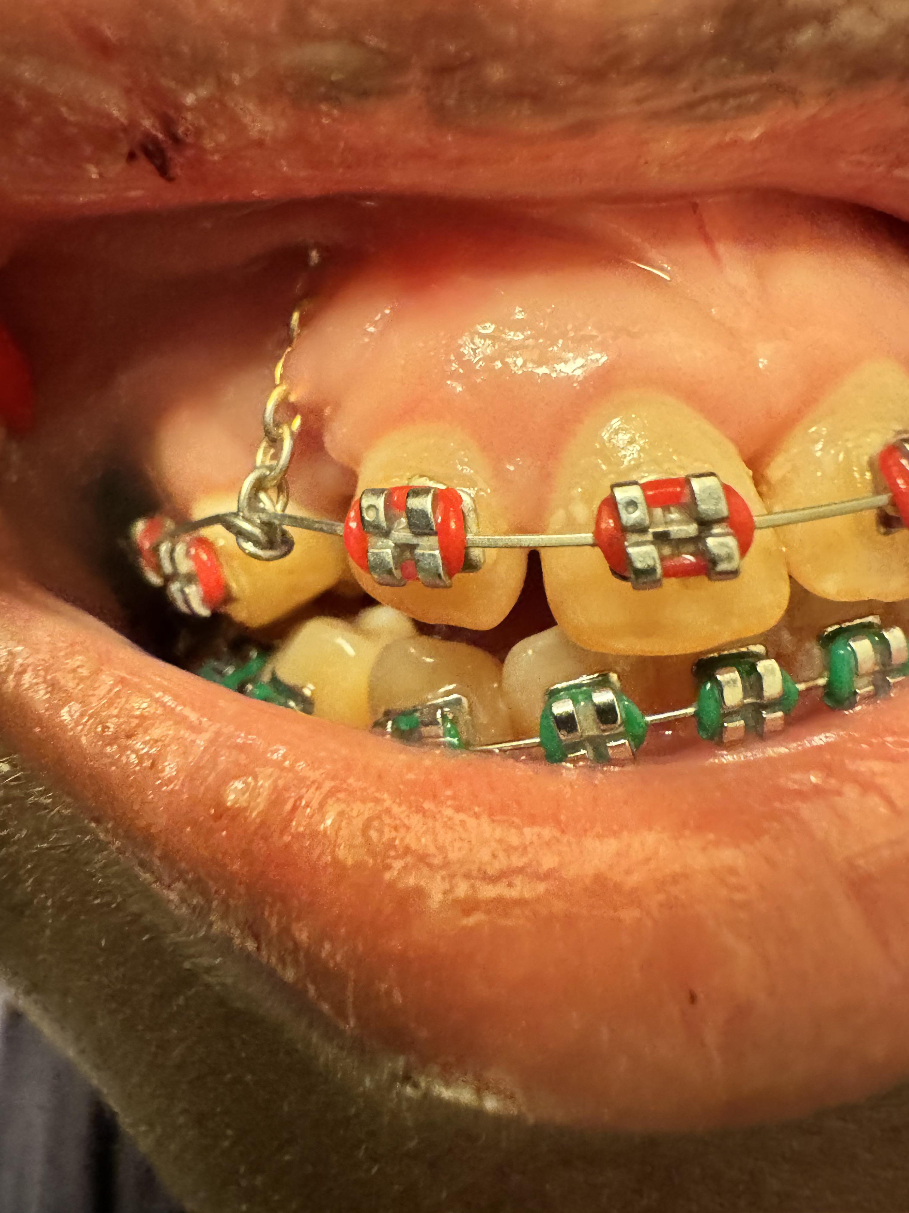 Does it look like my chain is coming out my gums? Should I go back to the oral surgeon? | Scrolller