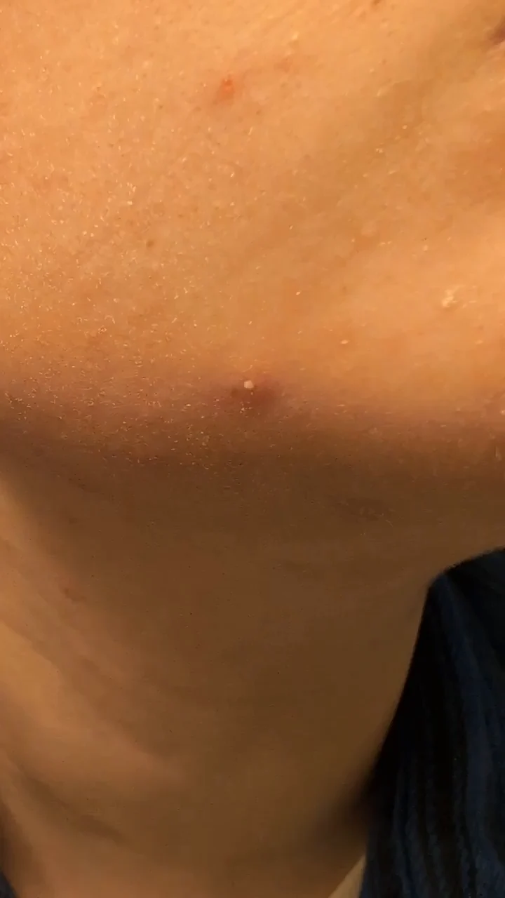 small one on my jaw | Scrolller