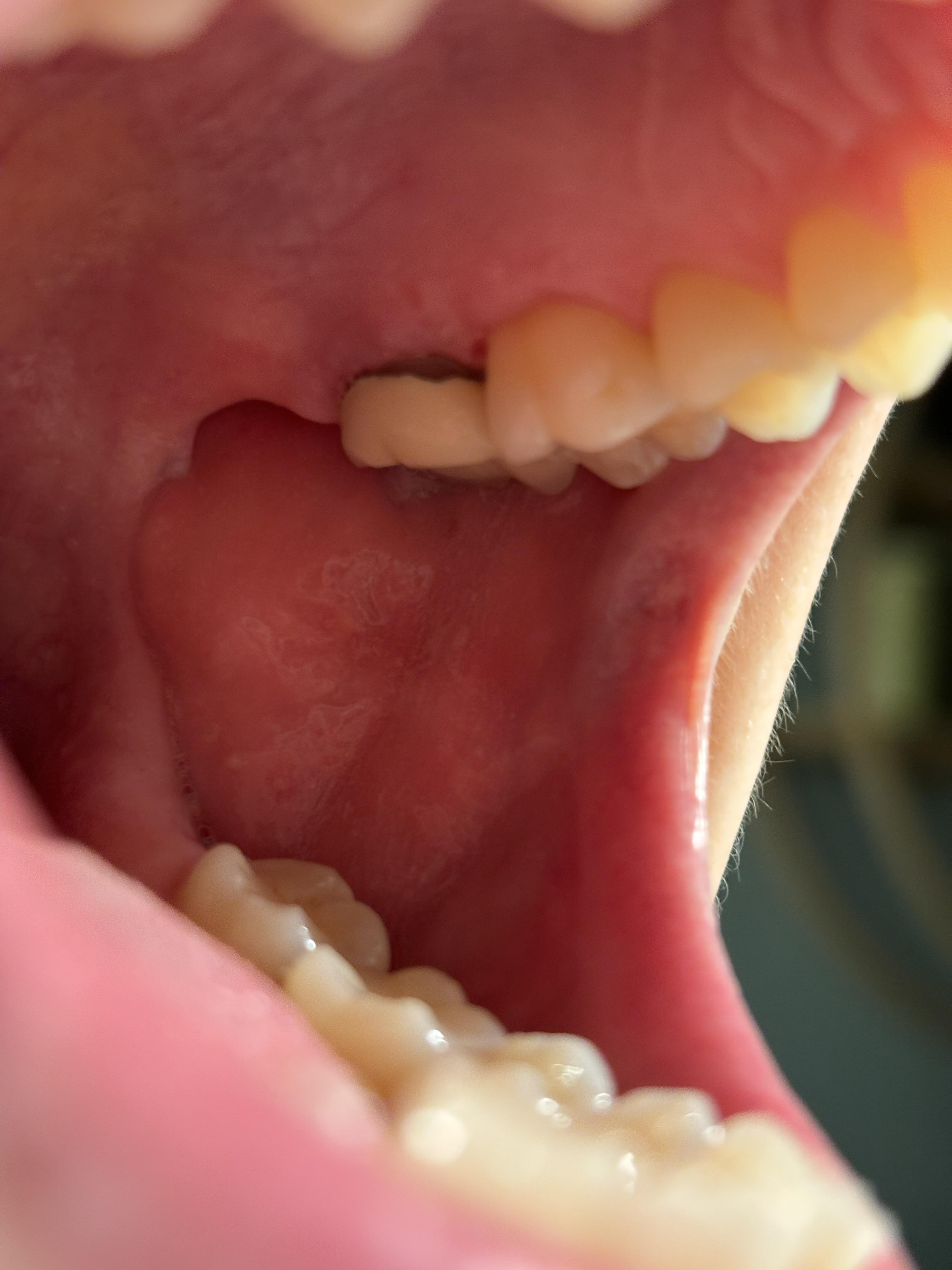 Help: Old root canal/crown pain | Scrolller
