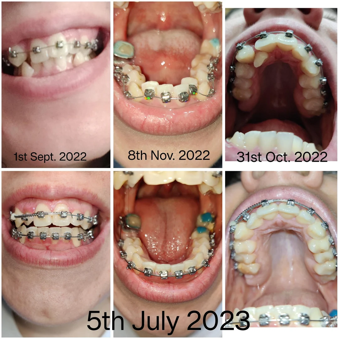 10 months since top braces, 8 months since bottom braces | Scrolller