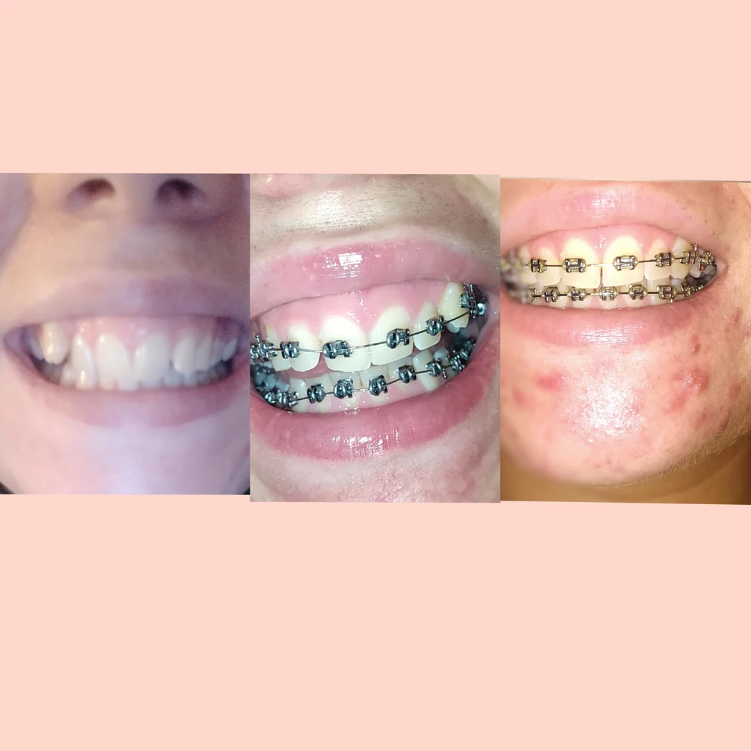 6 month update, 2 premolar extractions in April and bands next visit. Prediction is another 10 ...