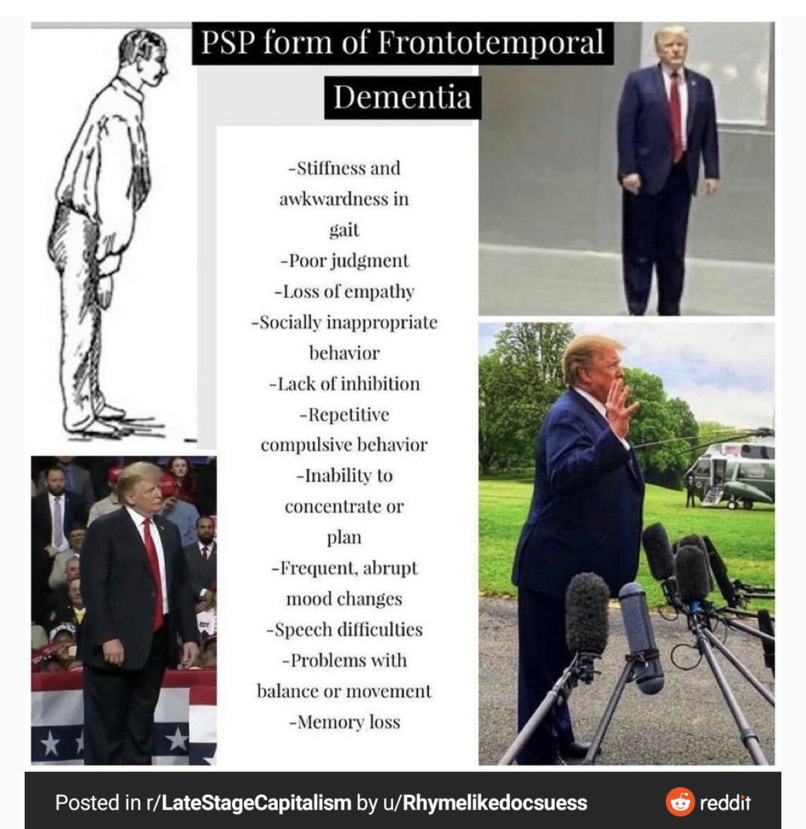 Frontotemporal dementia to be exact. | Scrolller