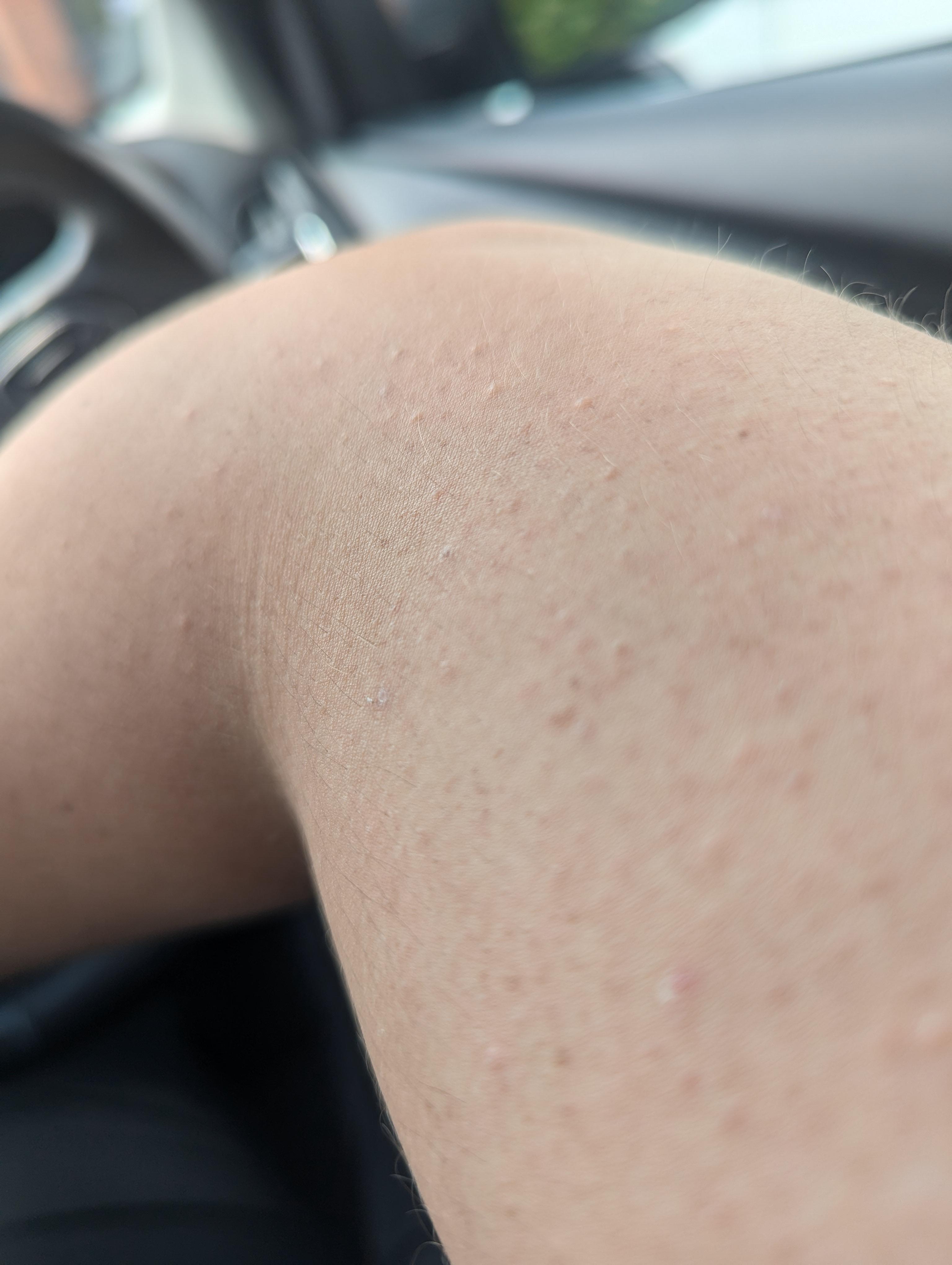 Bumps on hair follicles on arm | Scrolller