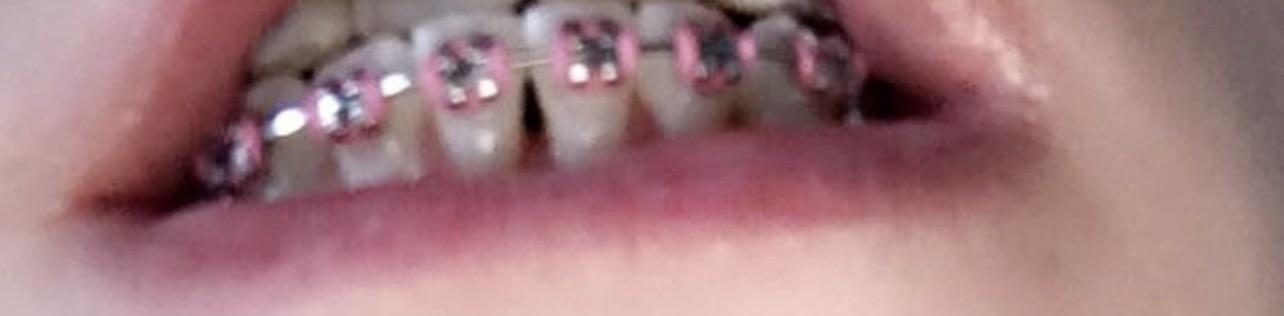 My black triangle is gone! My orthodontist is a wizard! | Scrolller