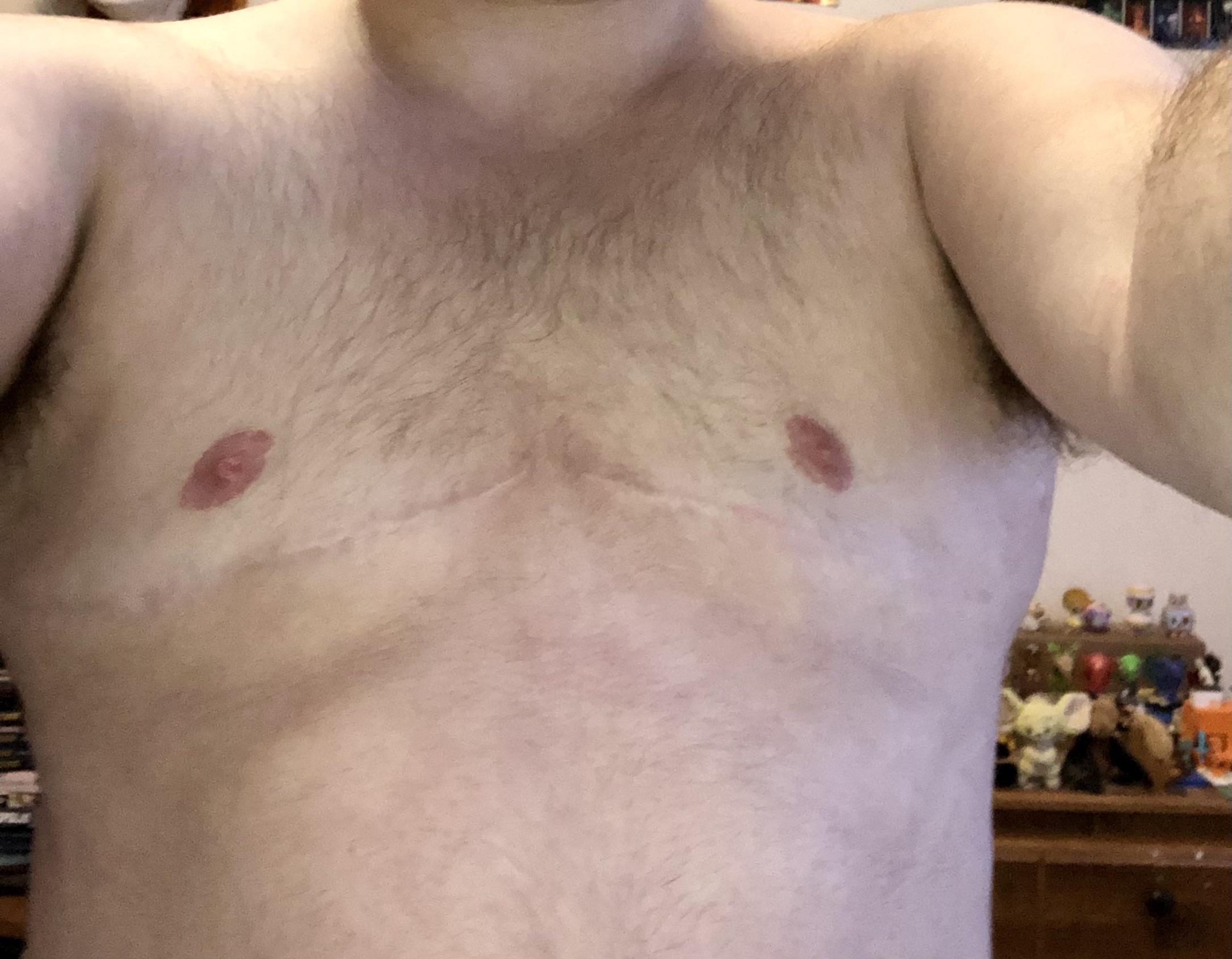 One year post op with Dr. Johnathan Keith | Scrolller