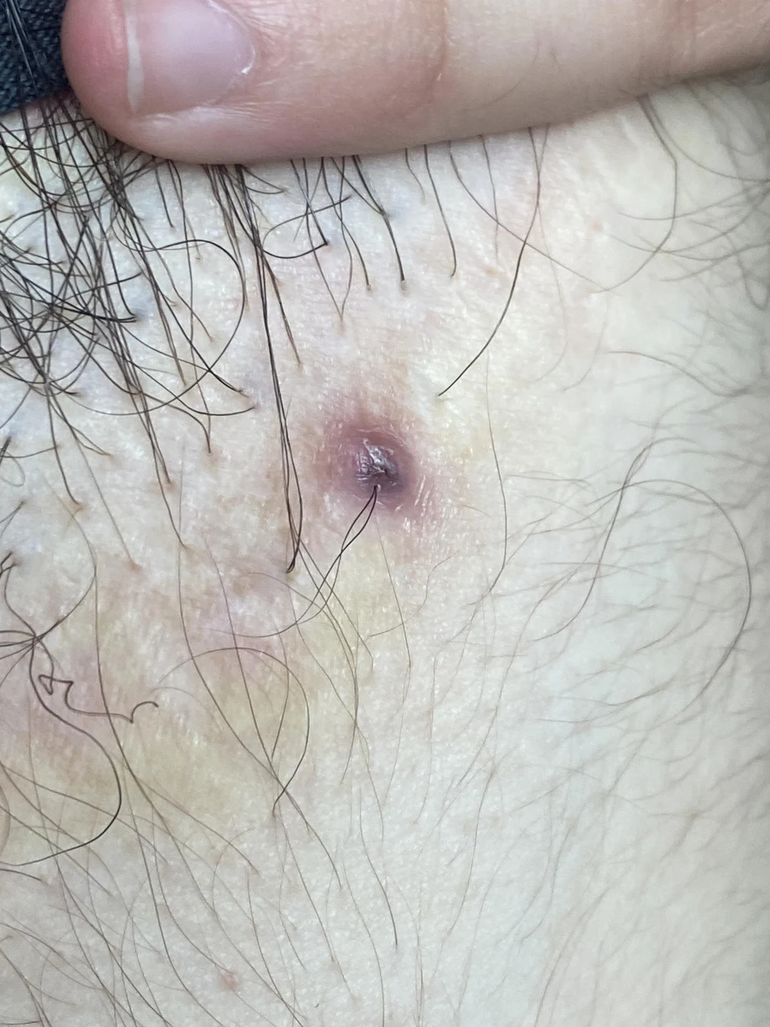 purple/red spot on scar 3 years post-op? | Scrolller