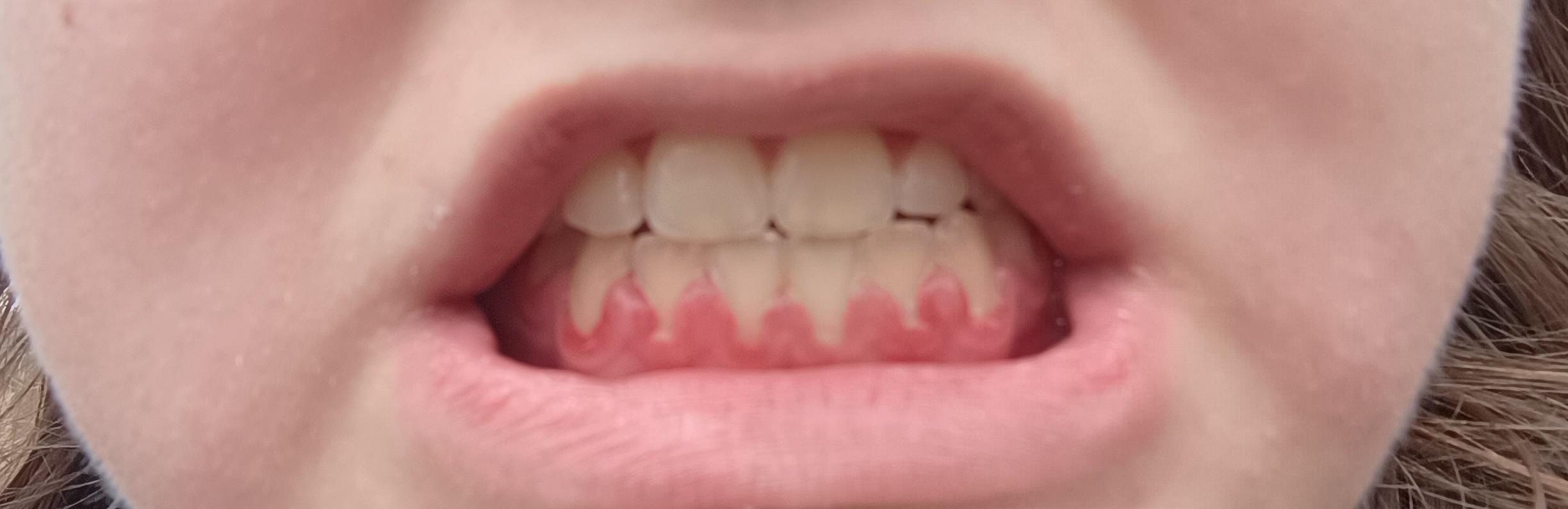 Just got my braces removed but my gums are so swollen. Is this normal? | Scrolller