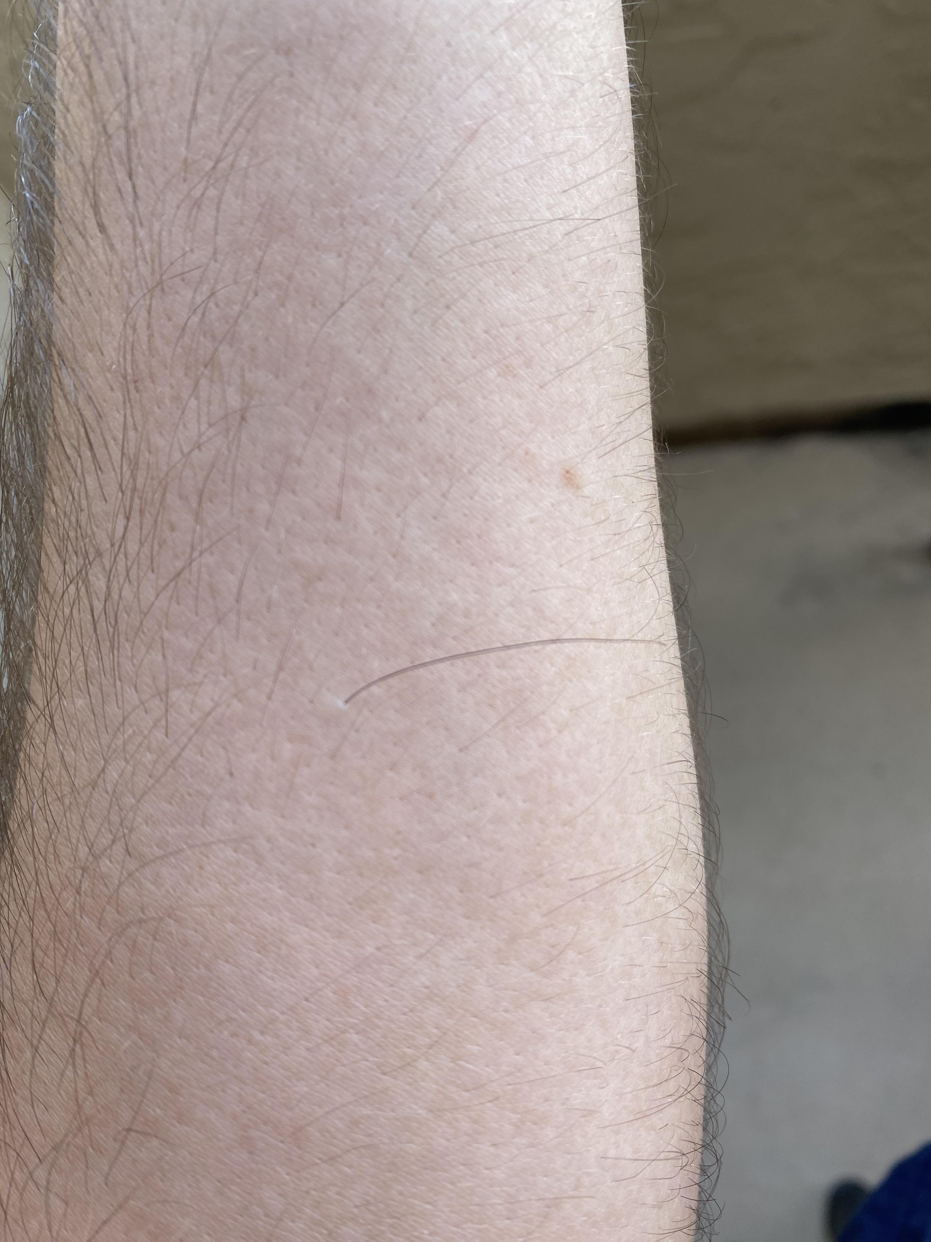 Kind of long dark hair on my forearm | Scrolller