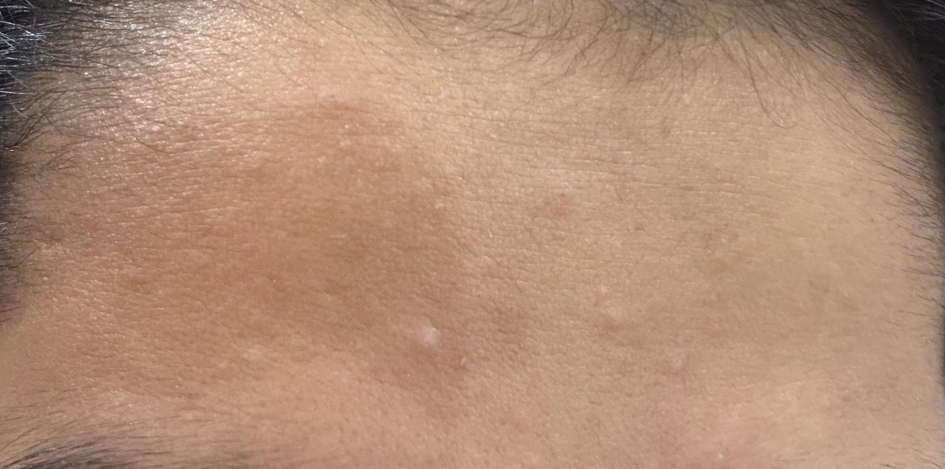 Tiny bumps on forehead | Scrolller