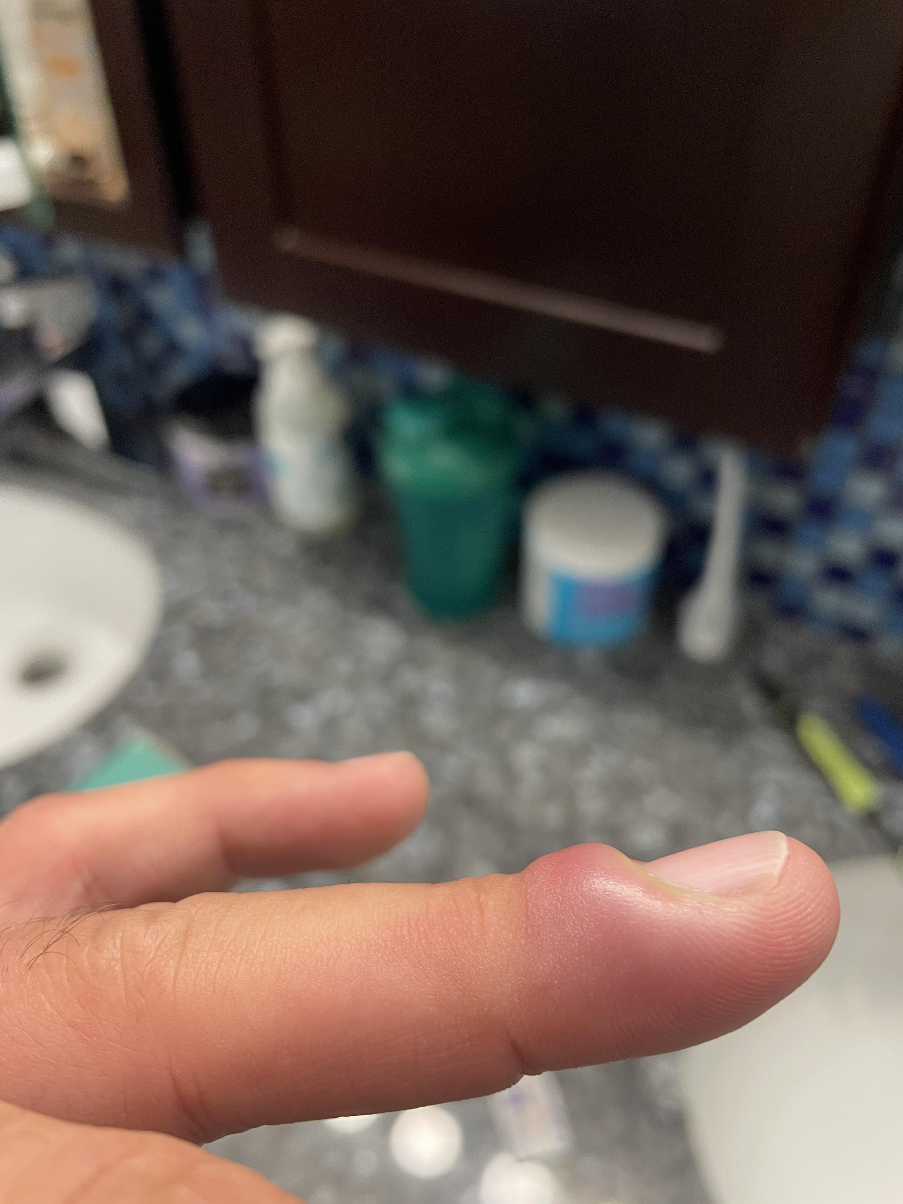 Finger Infection Looks Like it’s Going to Explode | Scrolller