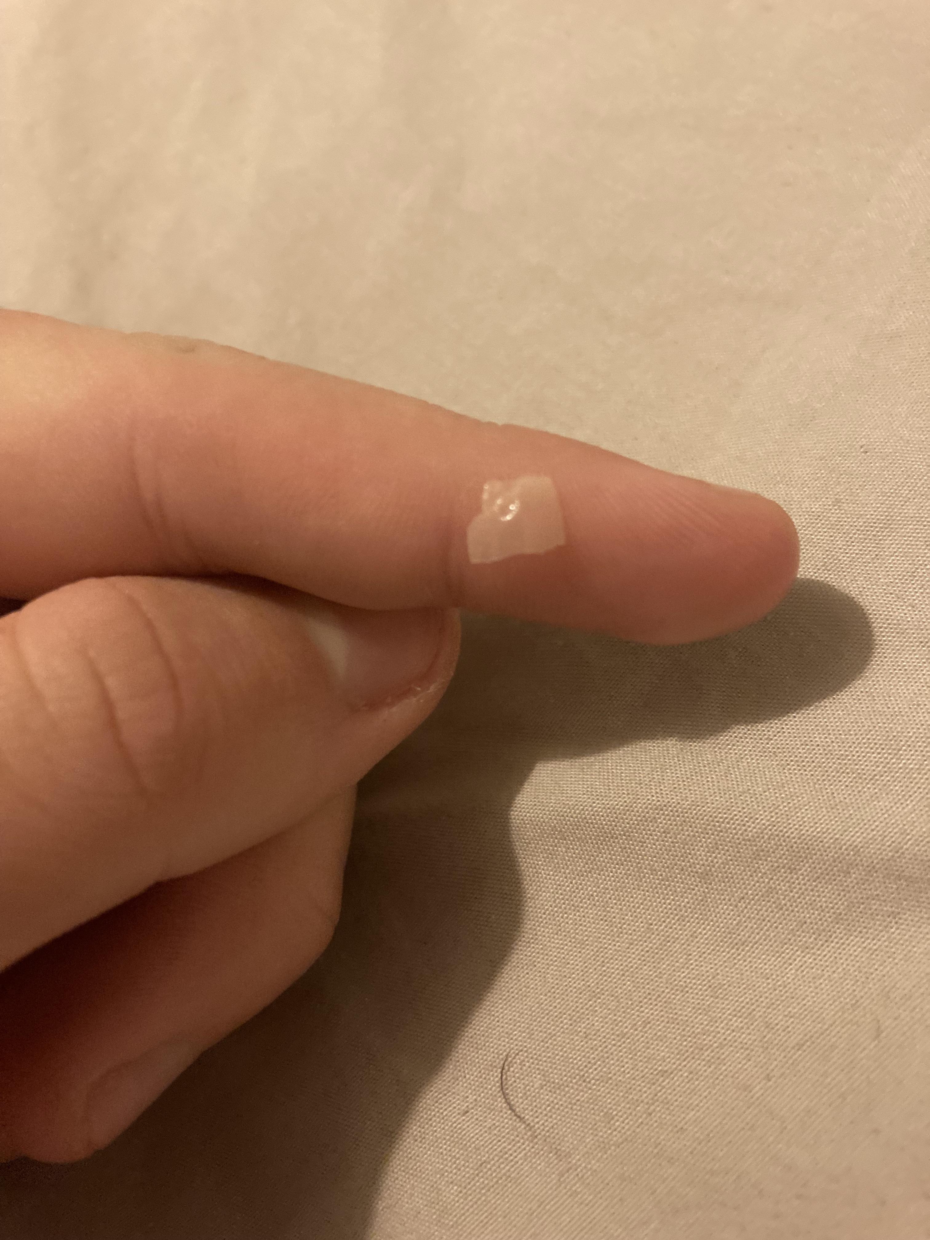 Weird thing on my finger | Scrolller