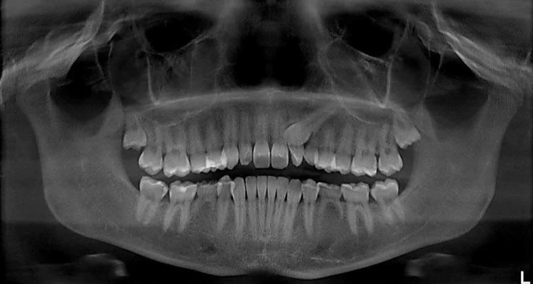 Surgery Tomorrow For Impact Tooth, Anyone Else Experience This? | Scrolller