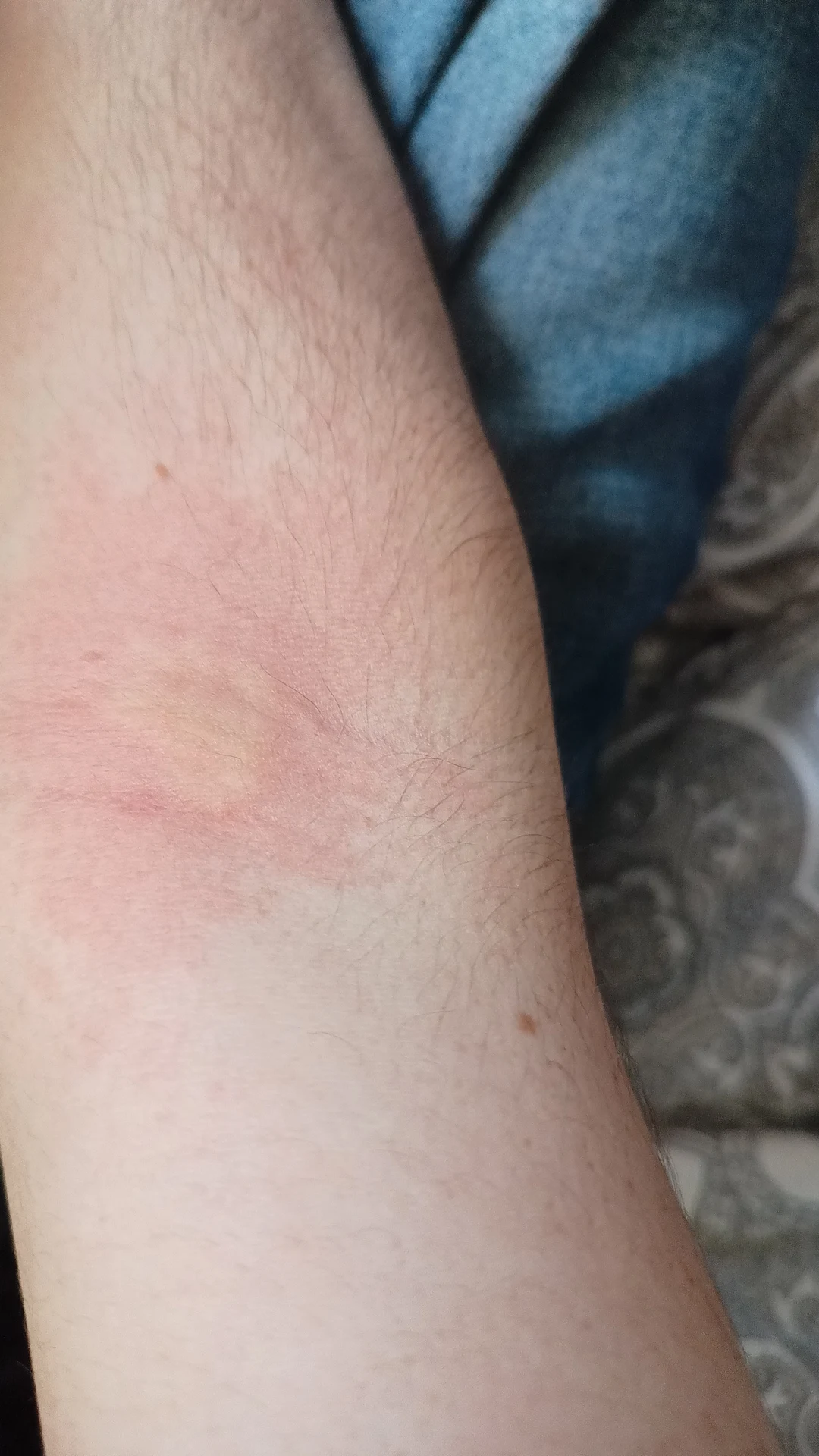 Slightly swollen injection site | Scrolller