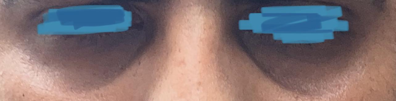 Any way to remove dark circles and hollow eyes naturally? | Scrolller