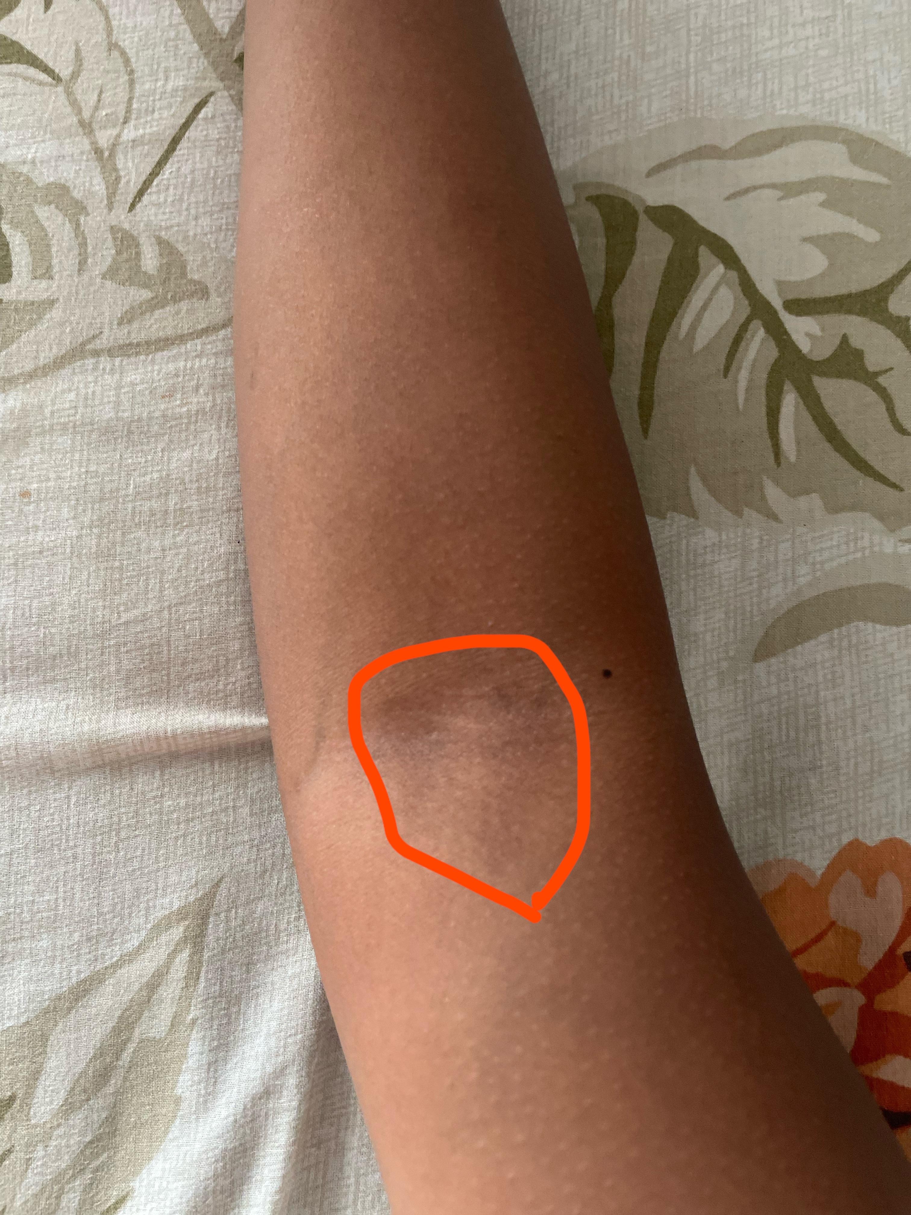 Dark patch w/o getting bruised | Scrolller