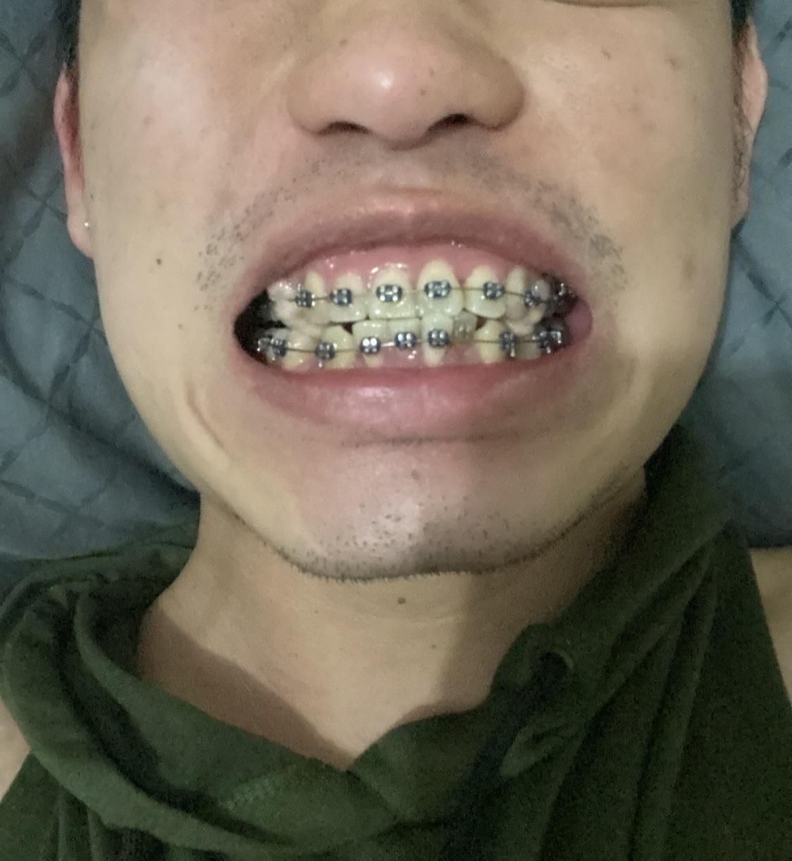 2nd month adjustment + upper premolar removal | Scrolller