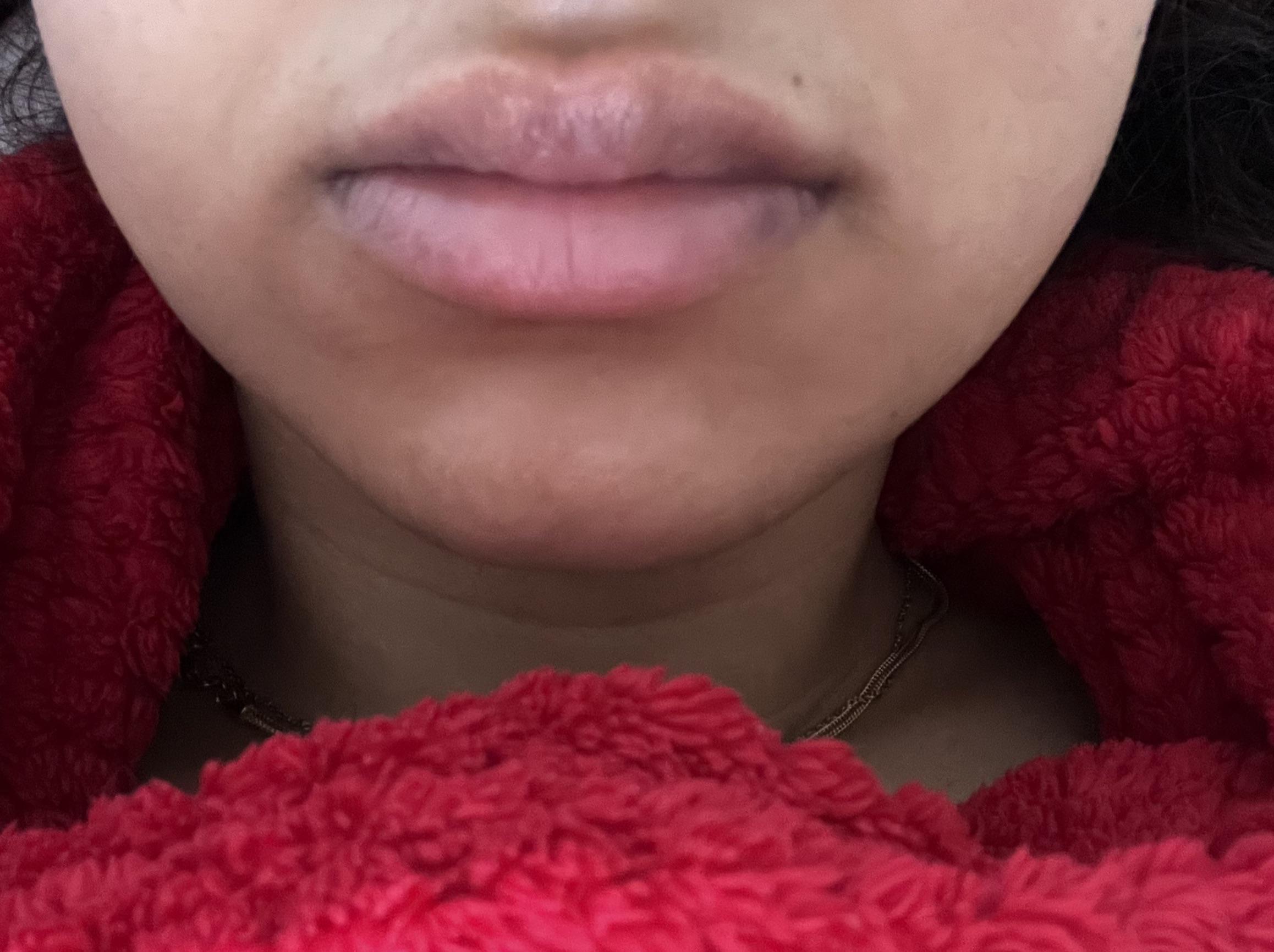 Lip filler | Scrolller