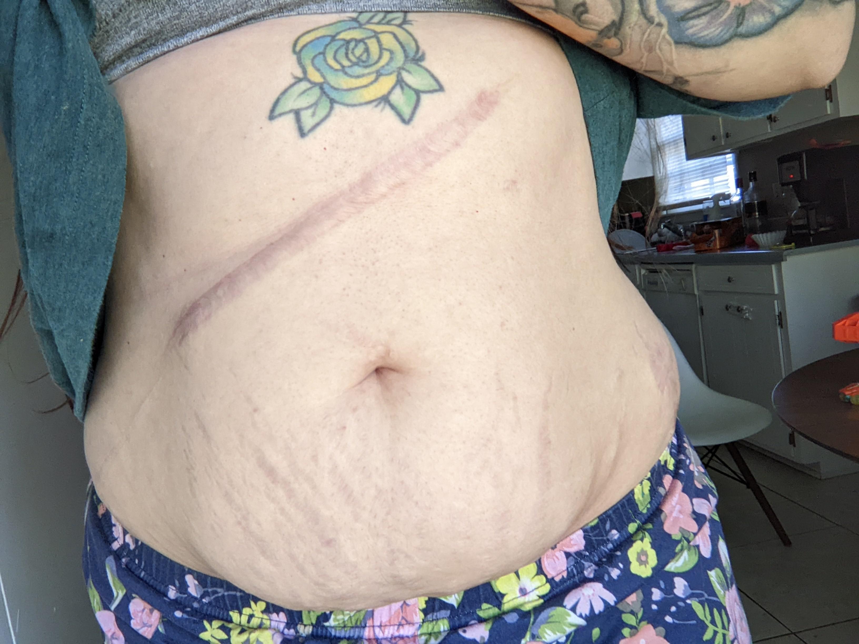 Help with incorporating an old self harm scar. More info in comments | Scrolller