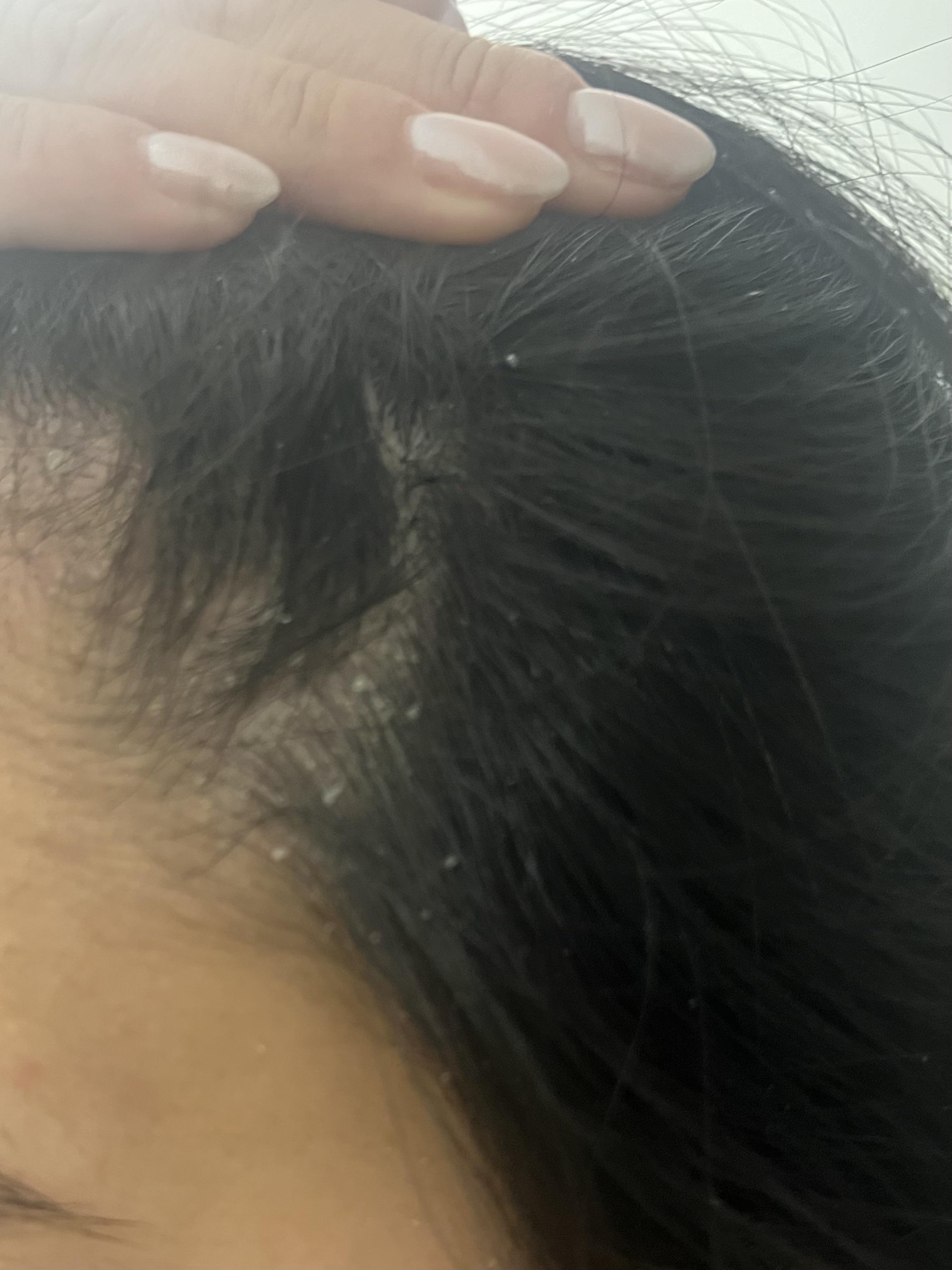 Extremely flaky scalp | Scrolller