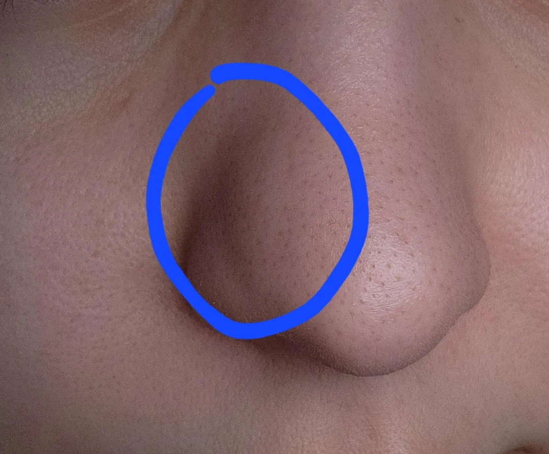 What is this little lump on my nose? | Scrolller