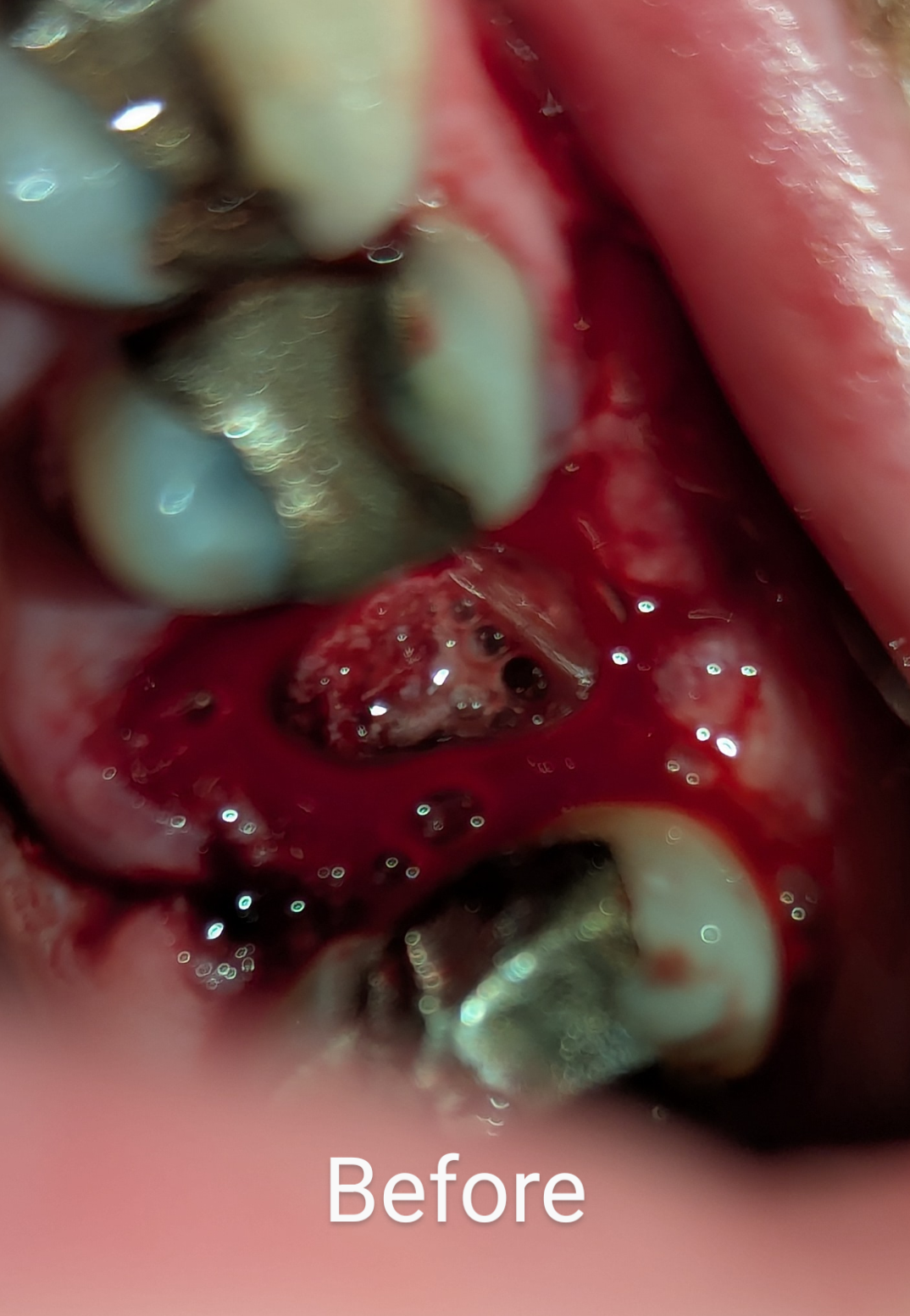 Discover more like Askdentists: Tooth extraction still bleeding after 6hours and Related Content ...