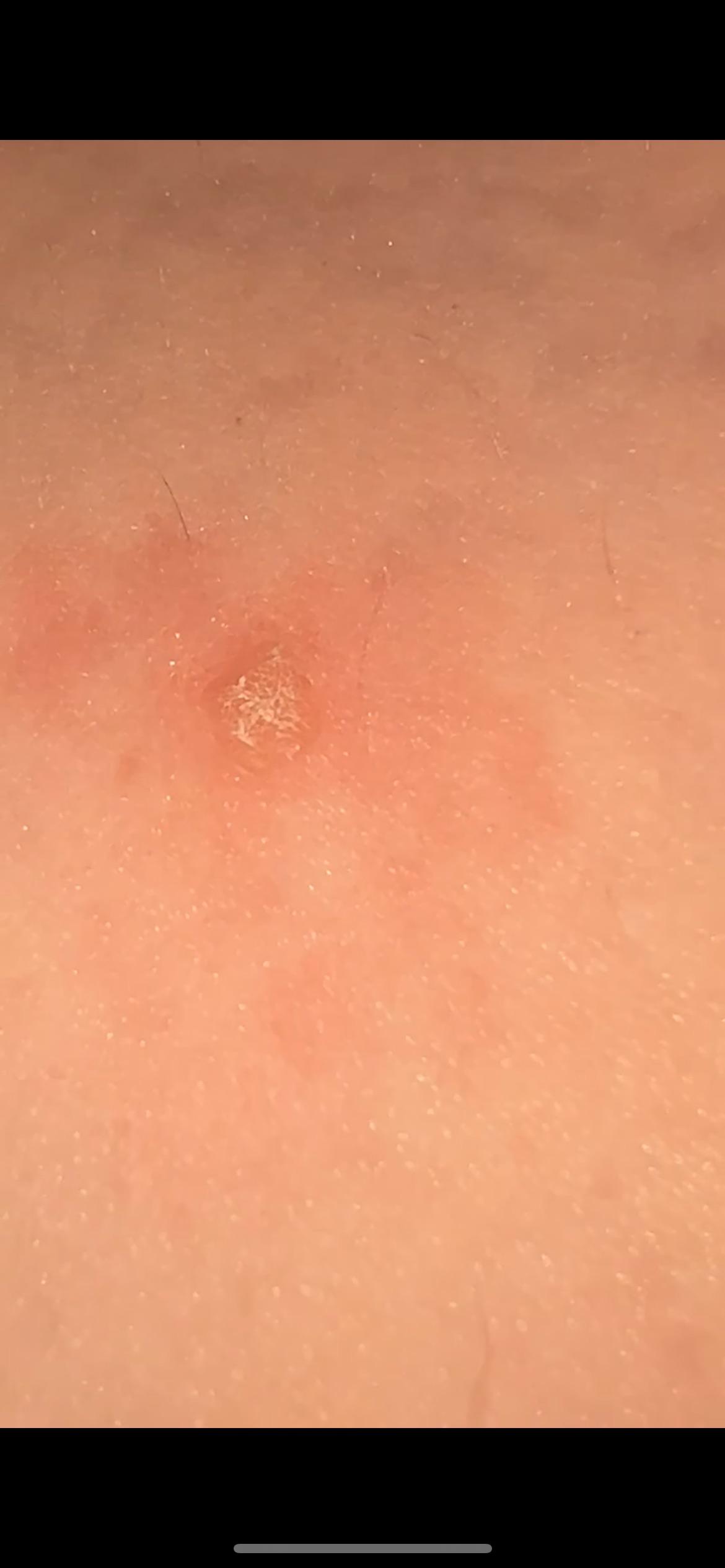 Skin bump | Scrolller