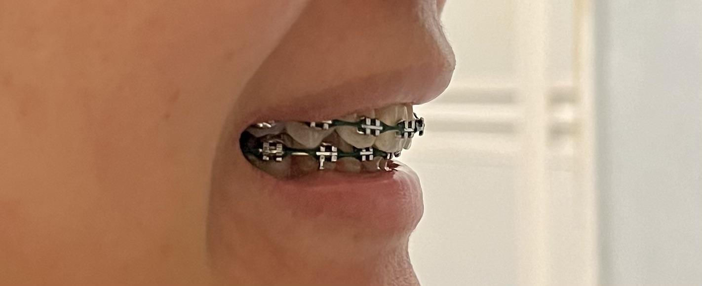 Discover More Like Braces Are My Braces Ready To Be Taken Off And Related Content Scrolller