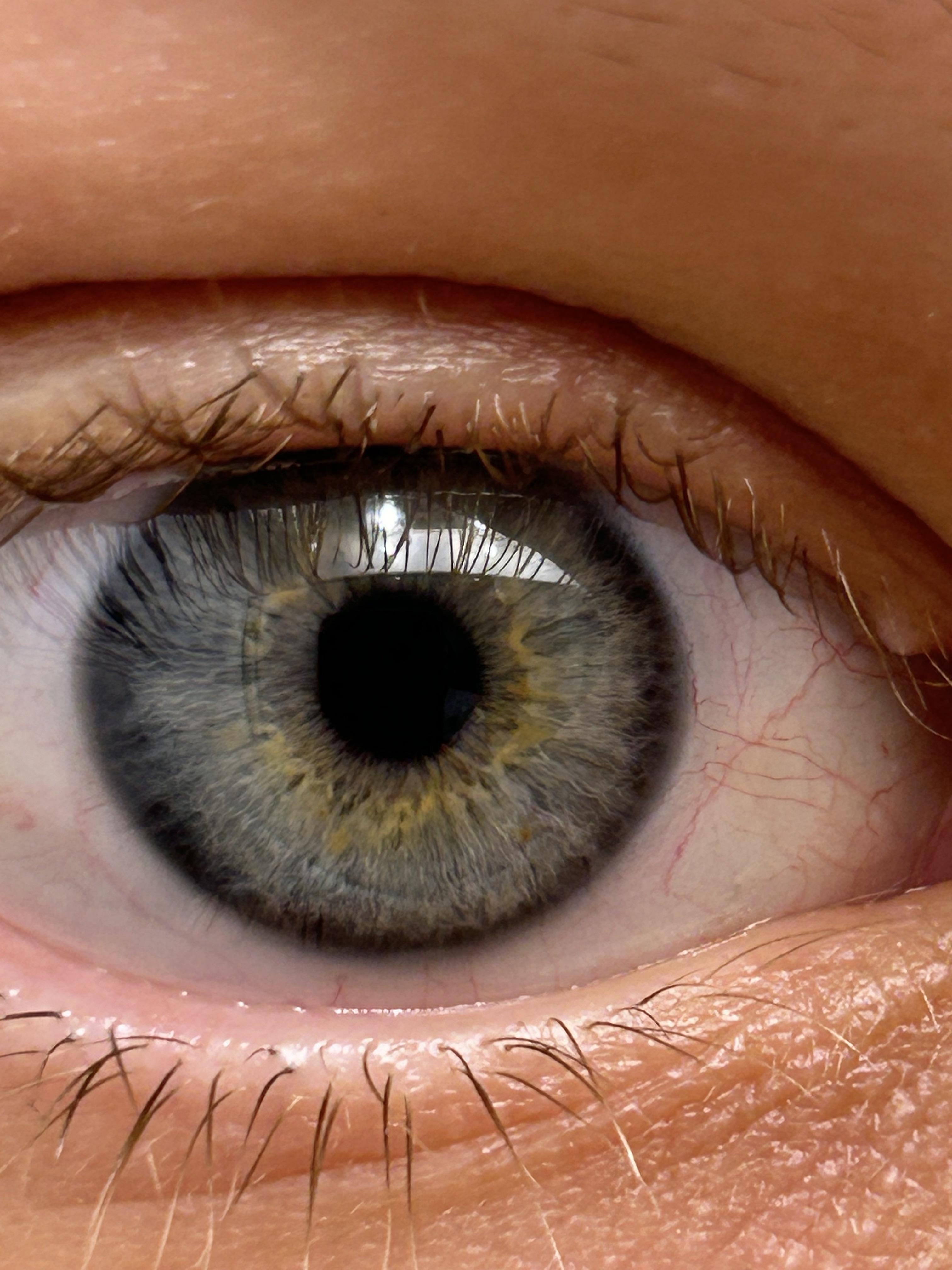 What is the yellow colouring in my eye called? And the shape is so stretched? Normal? | Scrolller