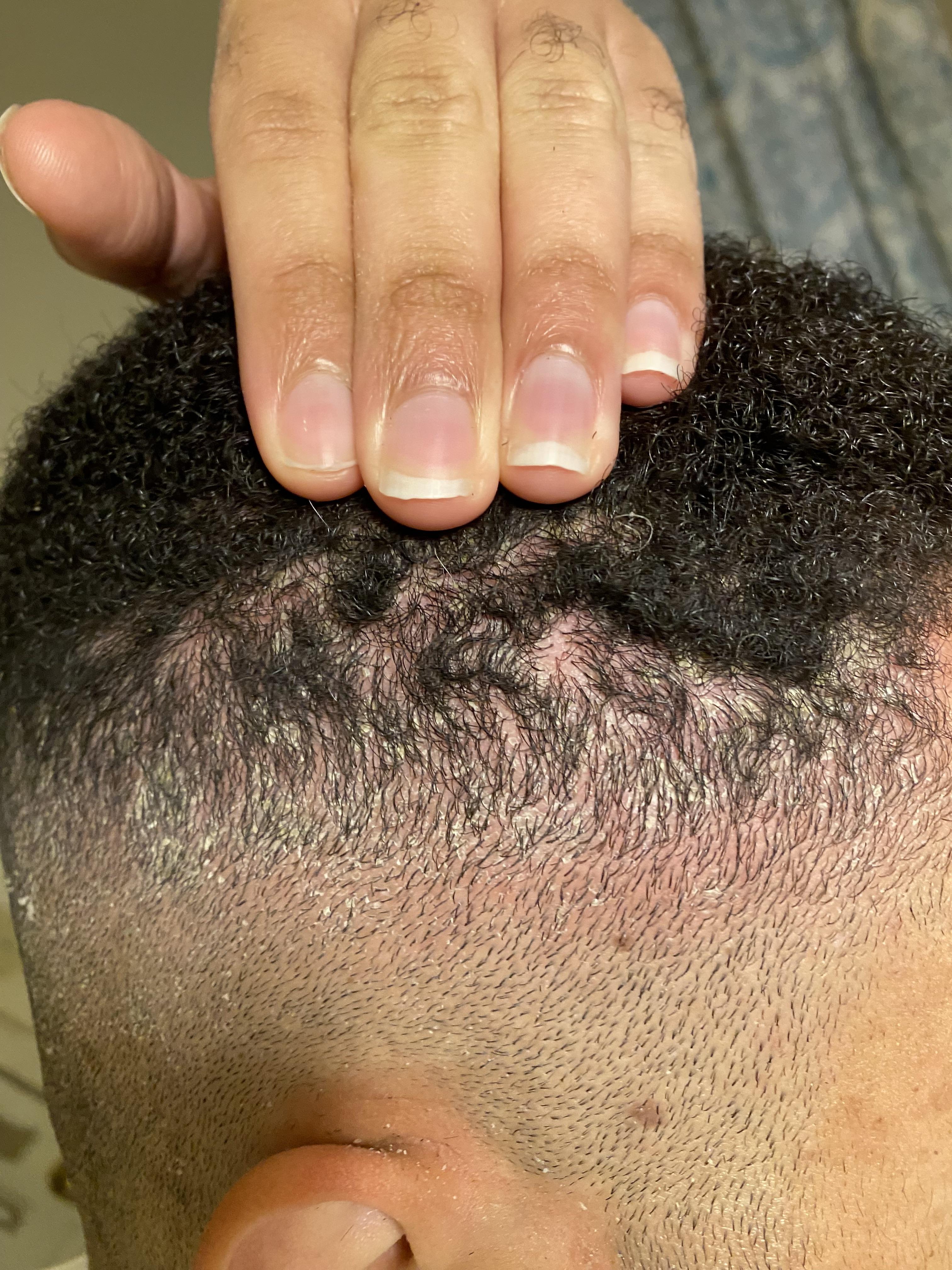 Shampoo For Dandruff Removal. | Scrolller