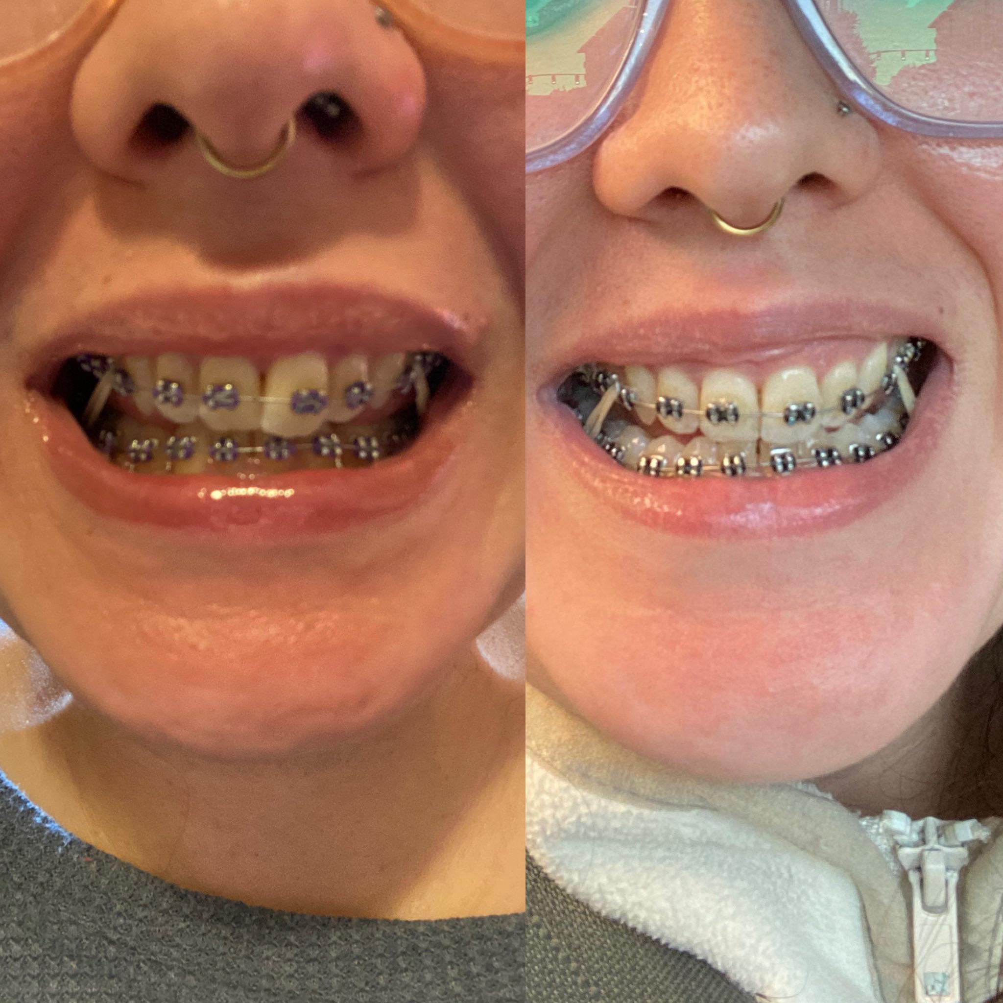 Braces progress! 6 weeks in!! | Scrolller