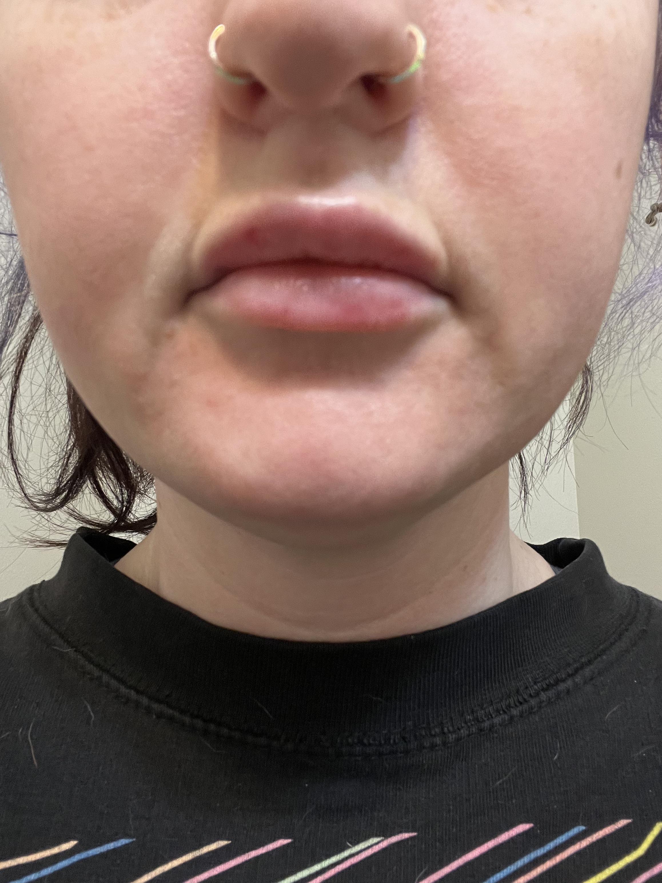 First time lip filler | Scrolller