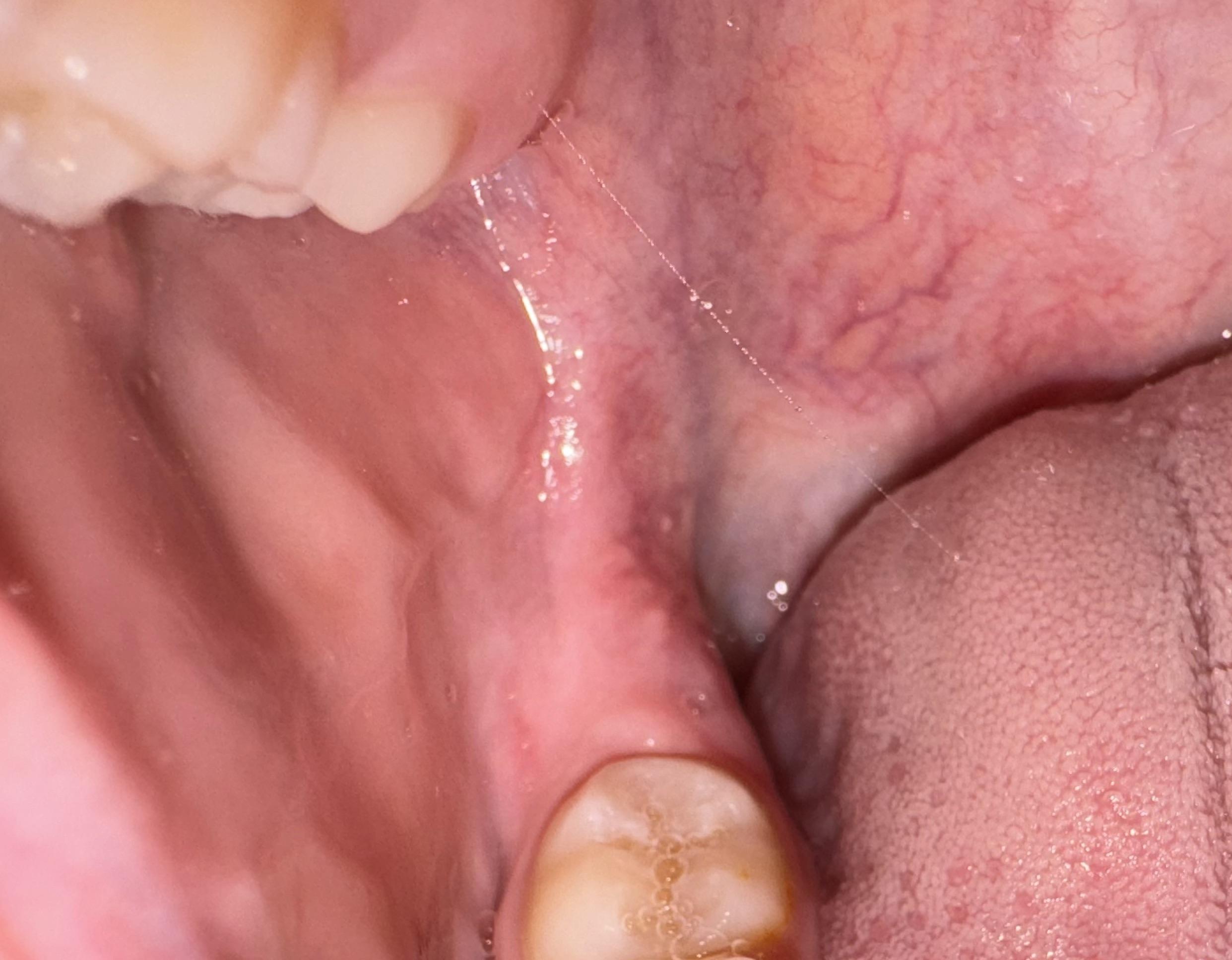 Weird bumps on top of back gums? | Scrolller