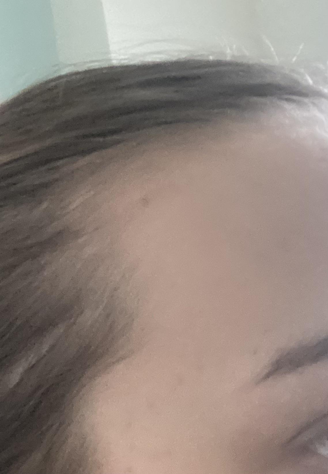 Why does no hair grow at my temples? My forehead looks like a rectangle! | Scrolller