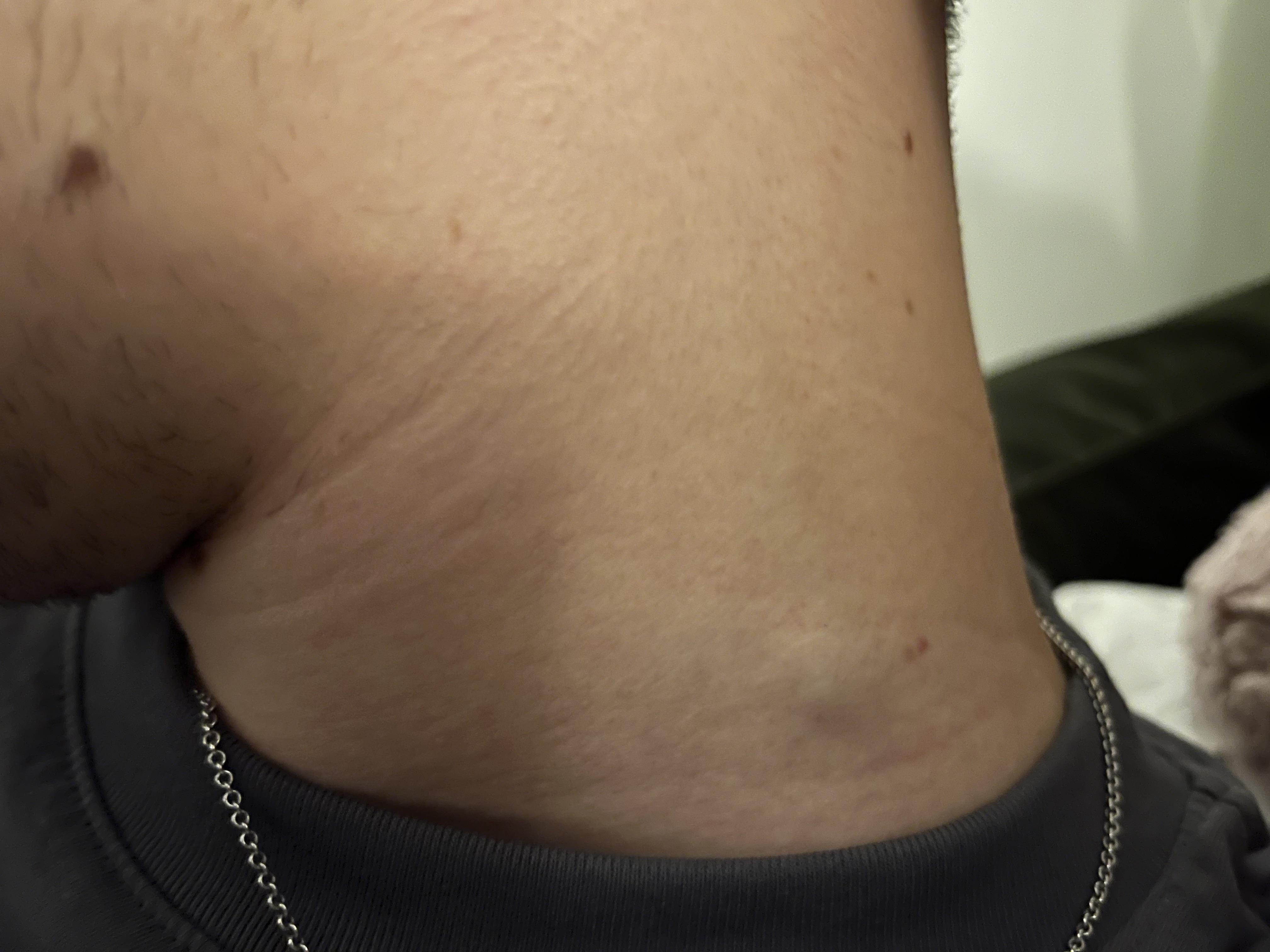 Bump on the left side of my neck | Scrolller