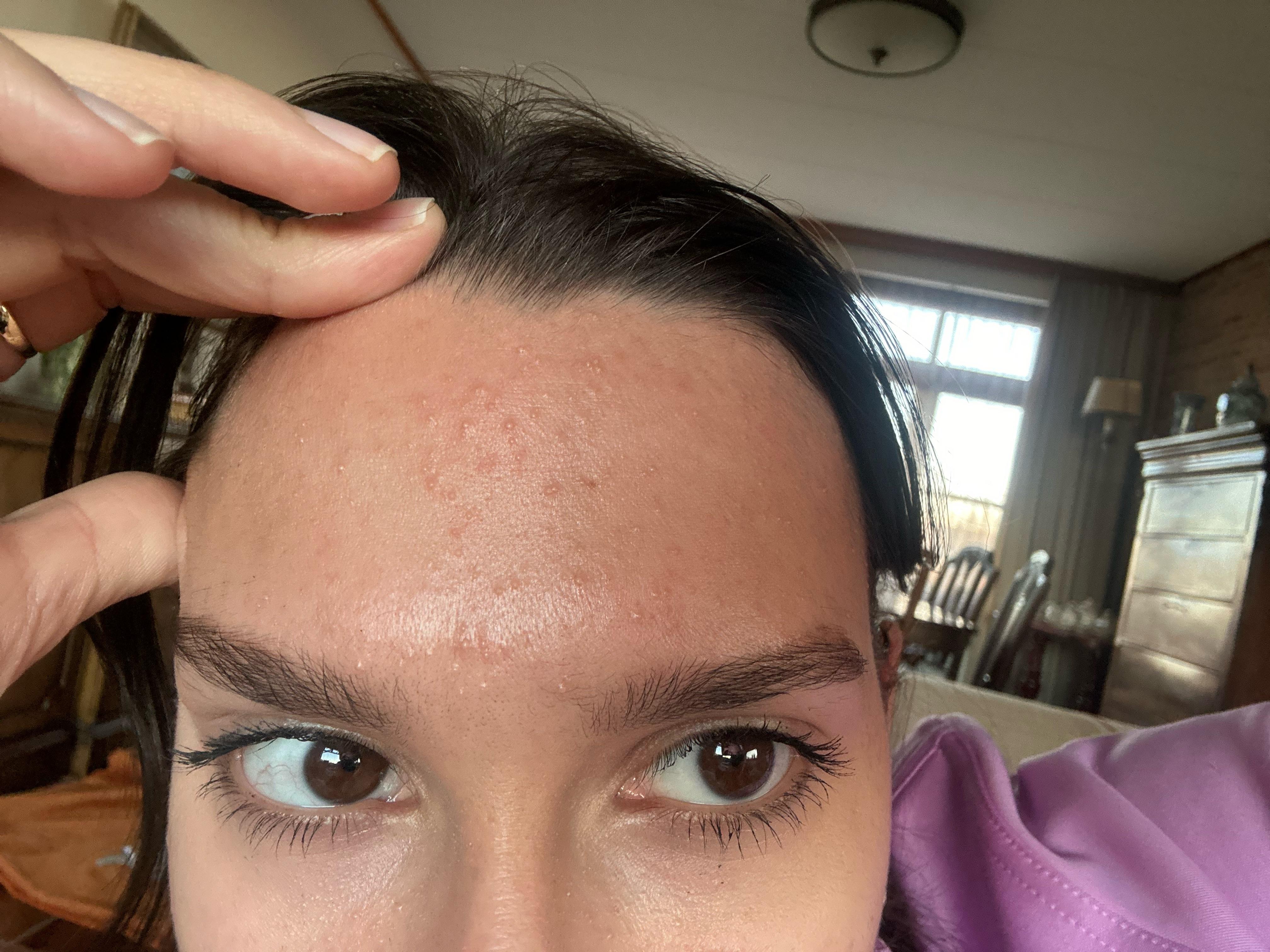 I developed these pimples recently | Scrolller